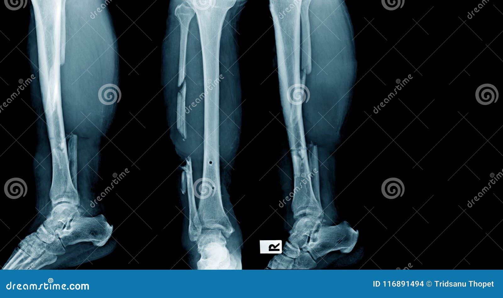Fractura de la tibia foto de archivo. Imagen de humano - 116891494