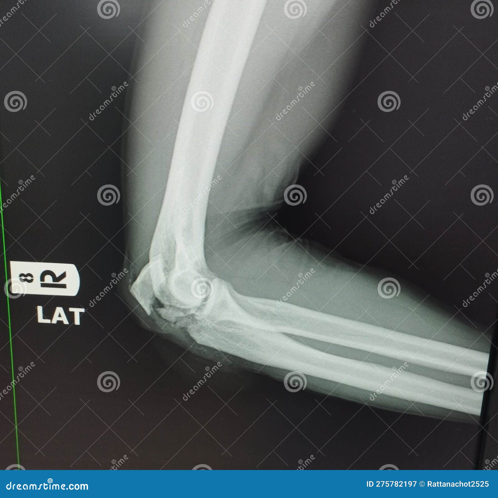 Fractura De Vista Lateral Del Codo Xris . Imagen de archivo - Imagen de ...