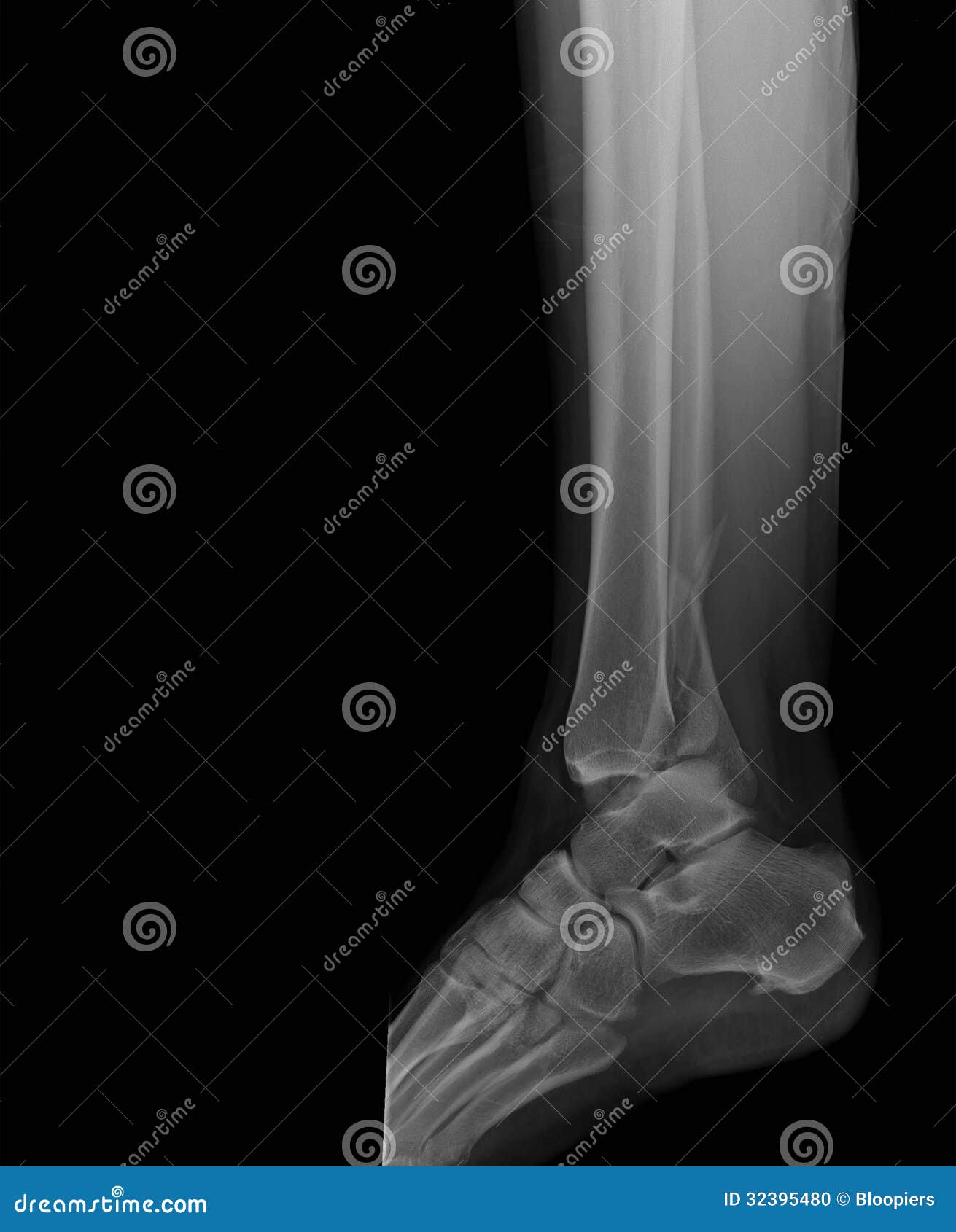 Fracturado foto de archivo. Imagen de llano, dolor, ortopédico - 32395480