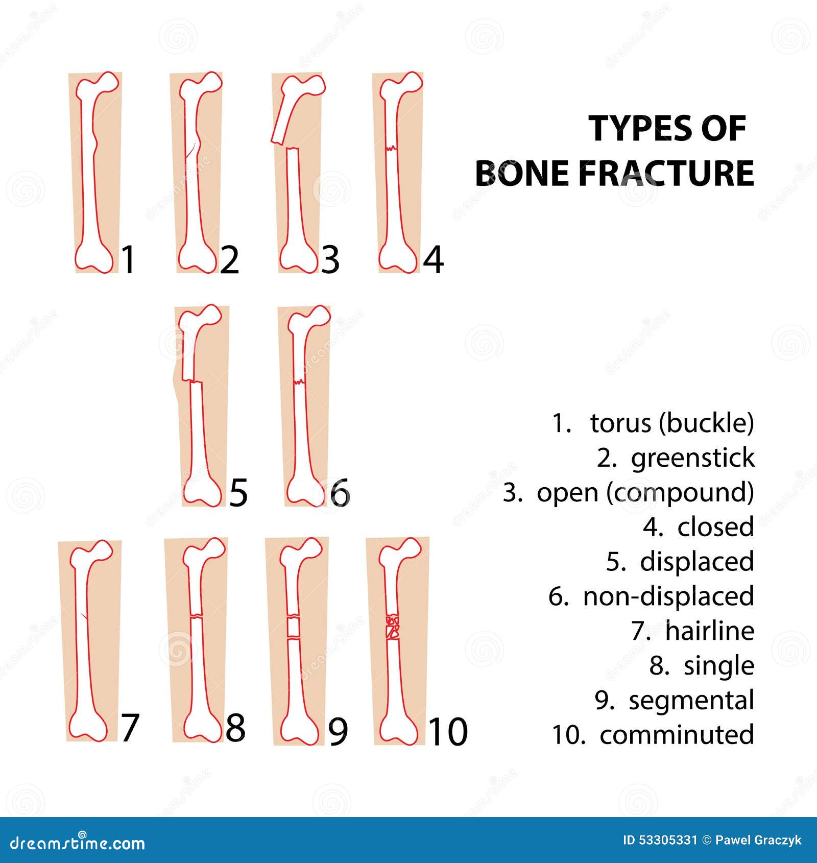 Fracturas de huesos ilustración del vector. Ilustración de médico ...