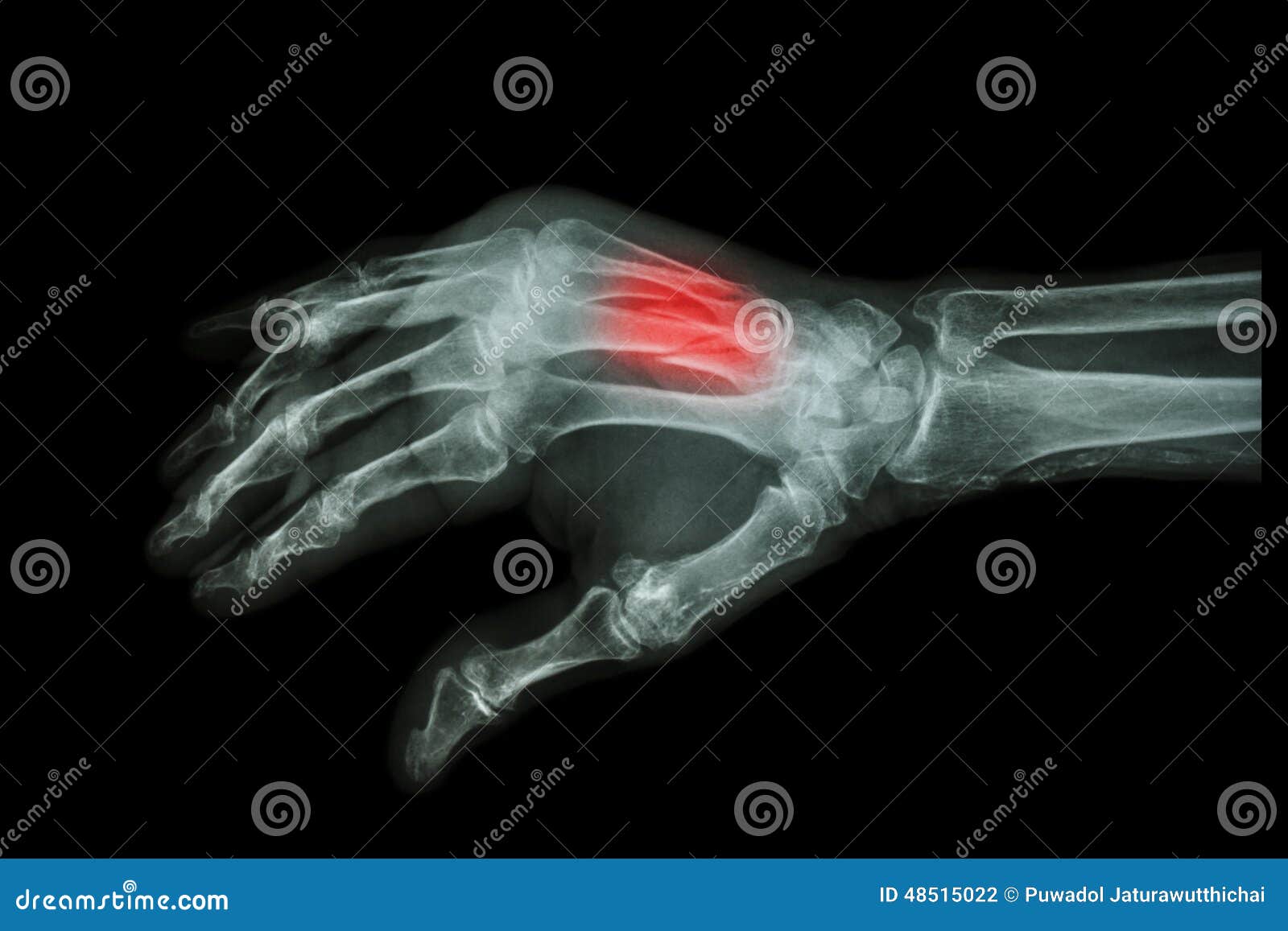 Fracture 3rd 4th Metacarpal Bone Stock Photos - Free & Royalty-Free ...