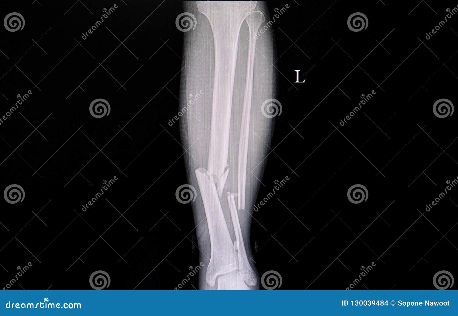 Fracture Both Bones of the Leg Stock Photo - Image of fracture, surgery ...