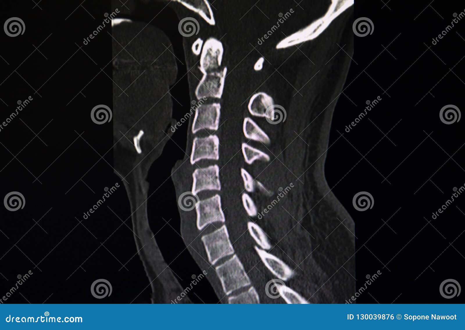 Fracture C2 Cervical Vertebrae. Stock Photo - Image of information ...