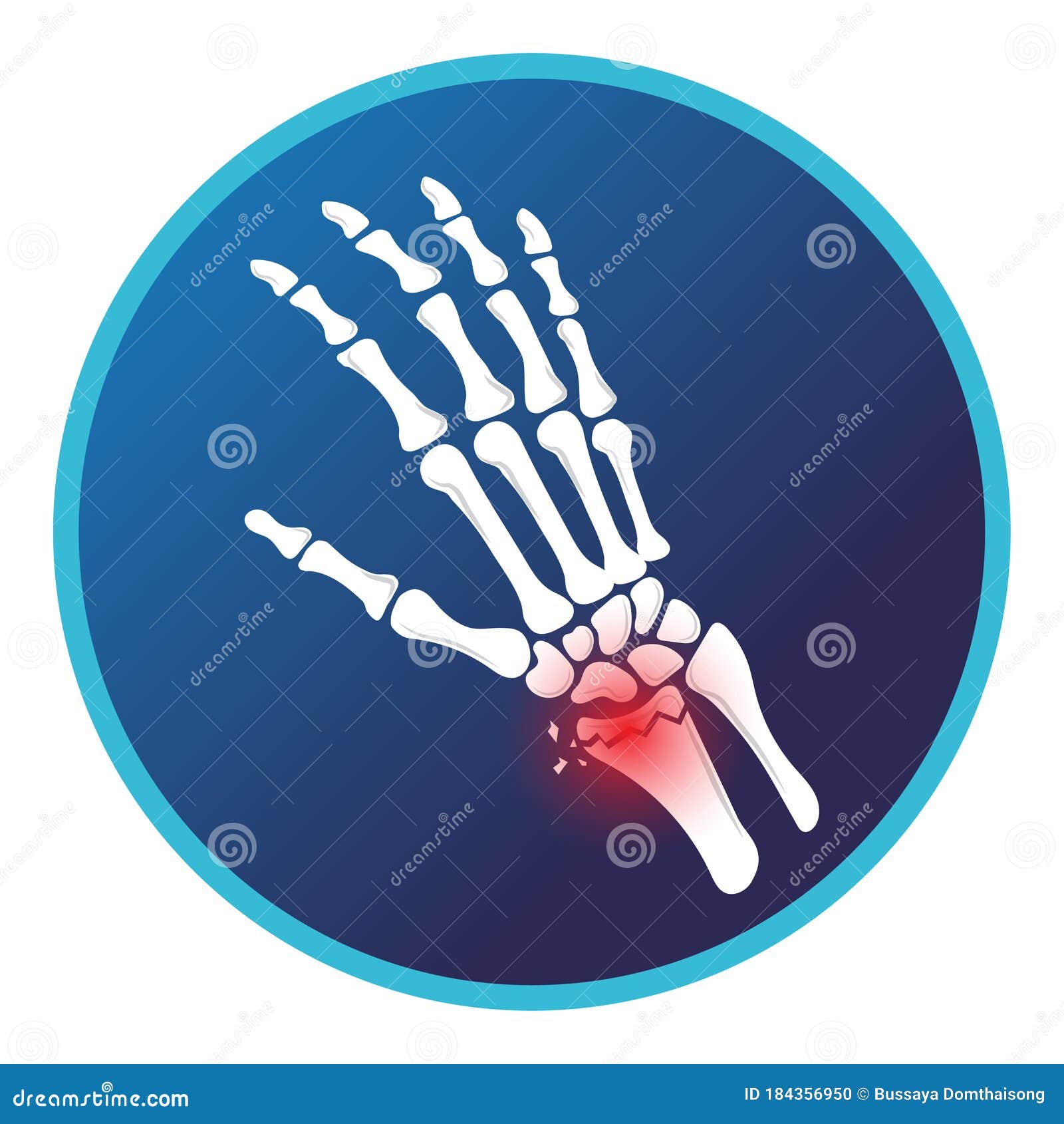 Distal Radius Fractures Cartoon Vector | CartoonDealer.com #46631151