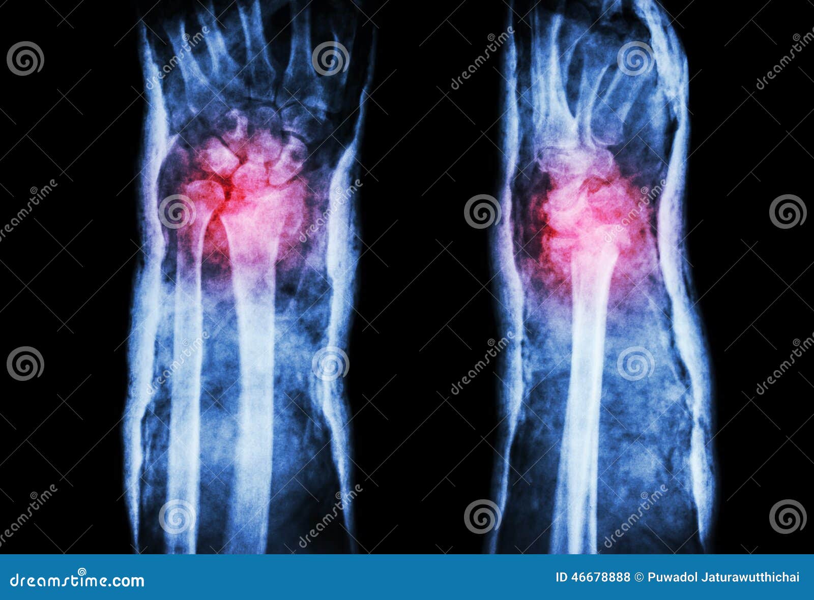 Fracture Distal Radius (Colles Fracture) and Cast Stock Photo - Image ...