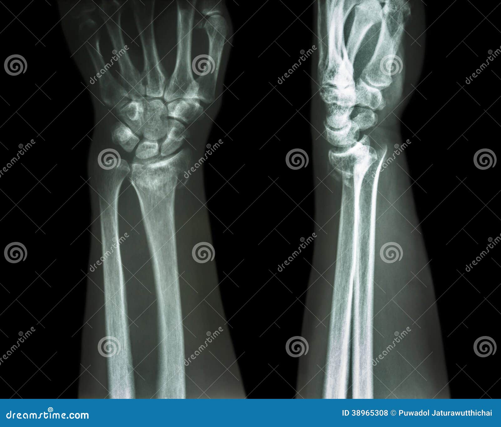 Colles Fracture Is A Complete Fracture Of The Radius Bone Close To ...