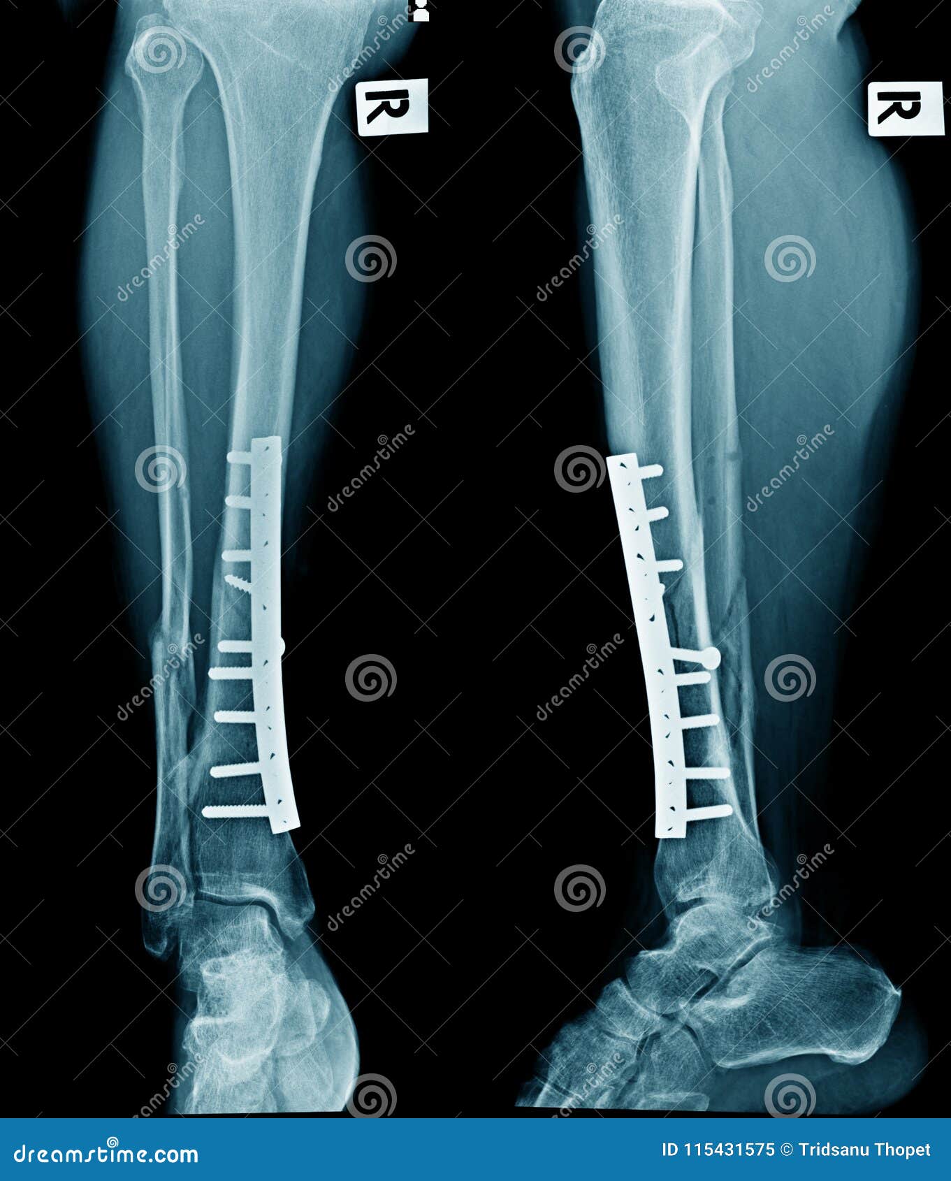 Fracture Distale De Tibia Et Fusion Fibular Distale Image stock - Image ...