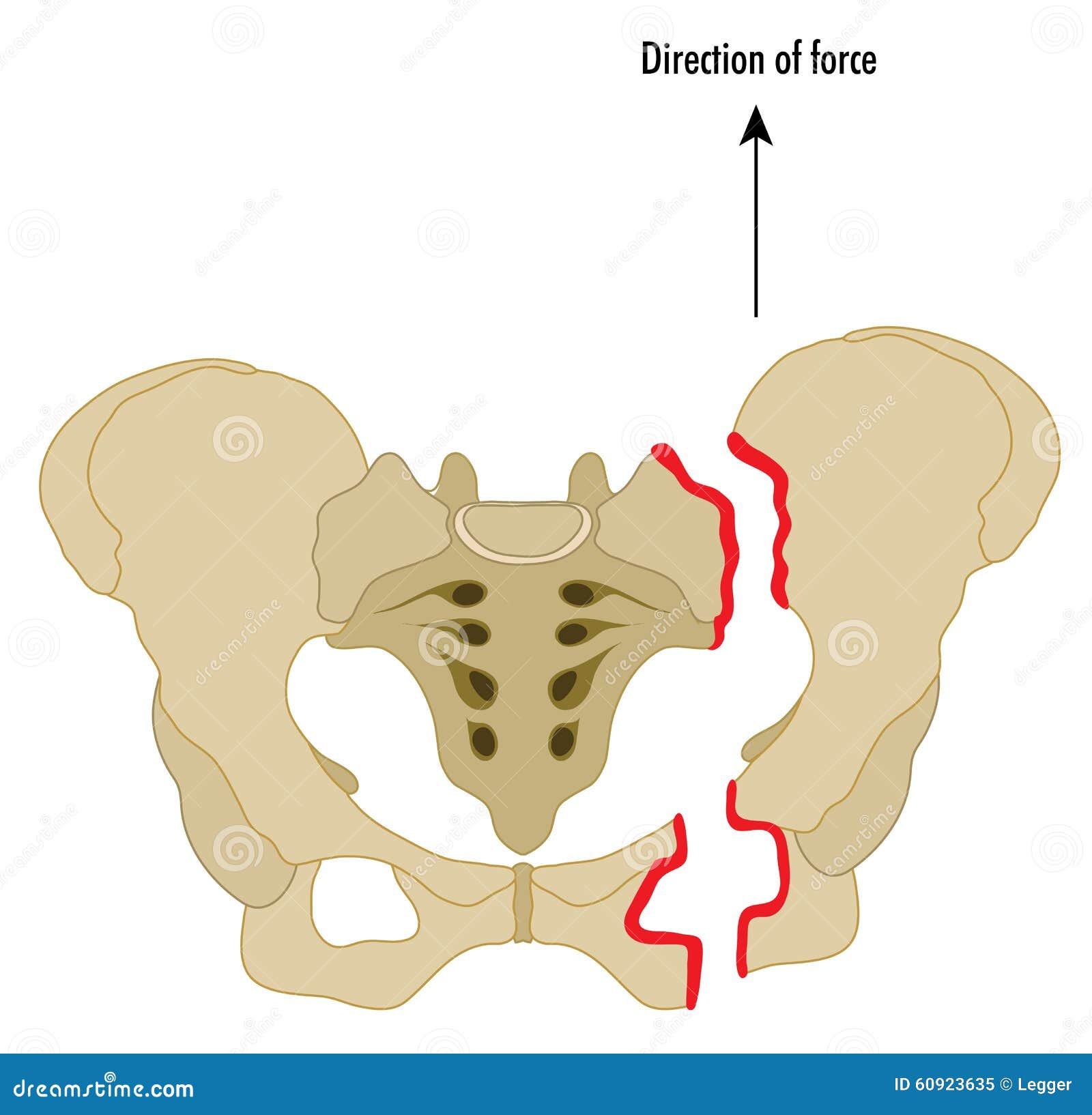 Fracture du bassin illustration de vecteur. Illustration du anatomie ...