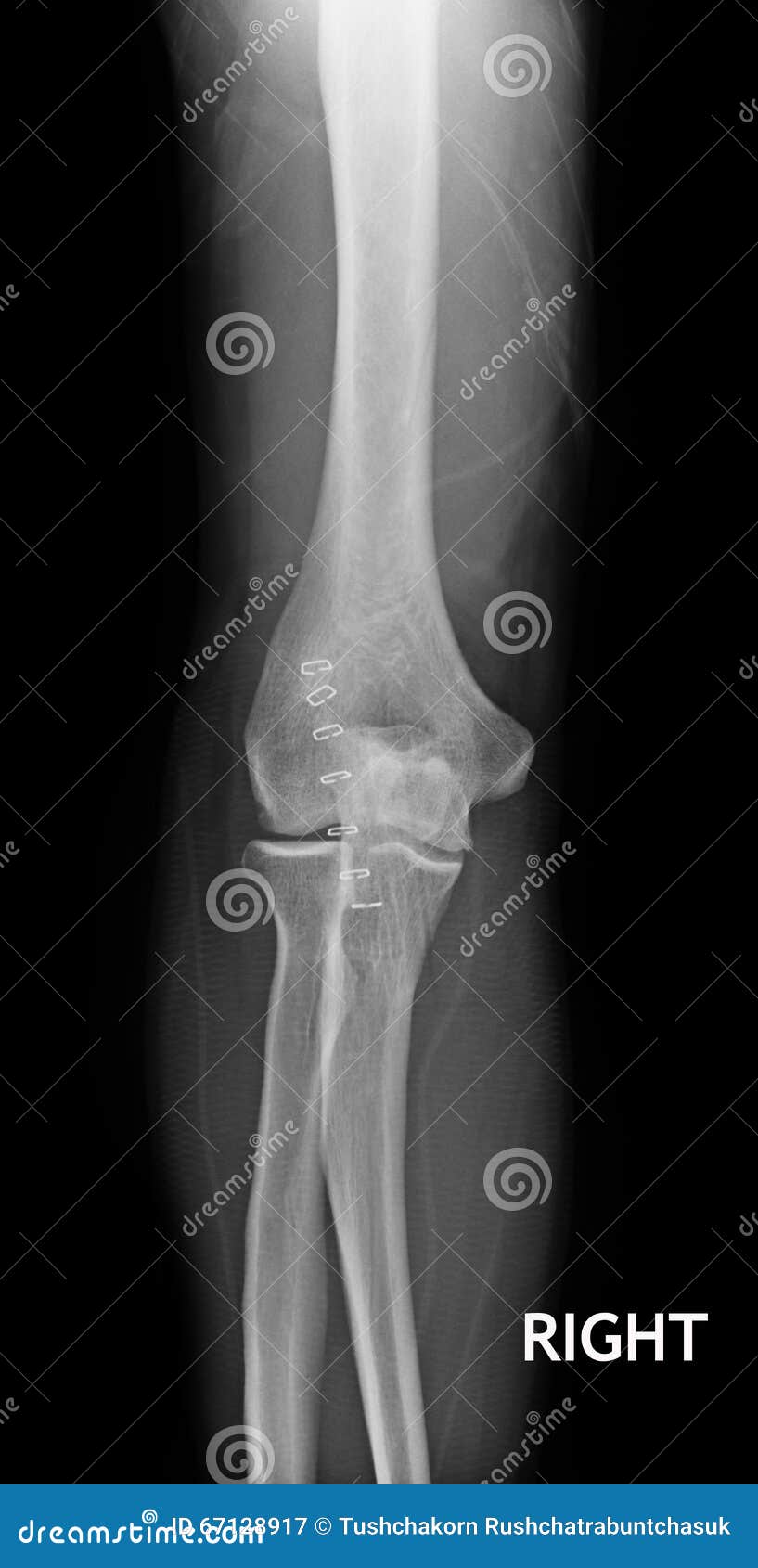 Forearm X-ray Showing Fracture Of Radius And Ulna Stock Photo ...