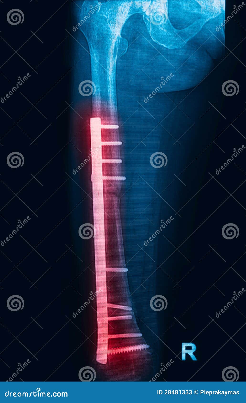 Fracture Femur, Femur X-rays Image Stock Image - Image of fracture ...