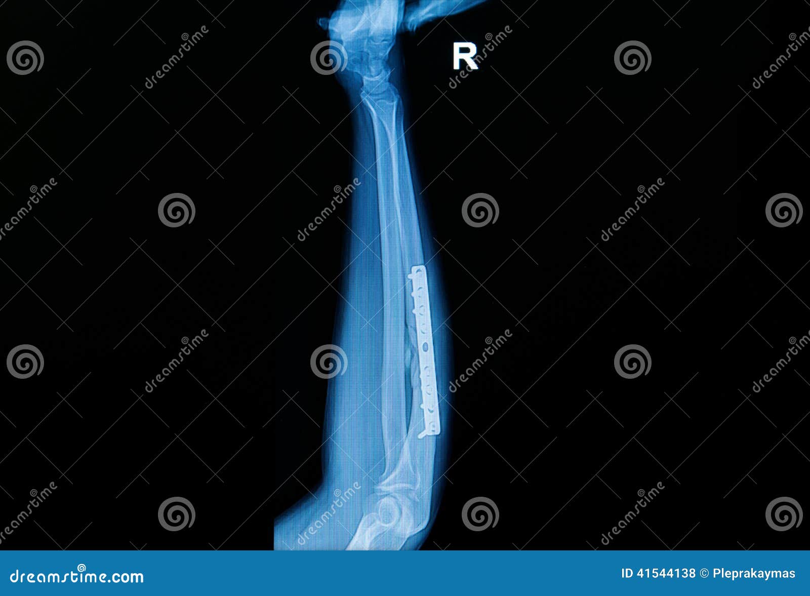 Fracture Forearm with Internal Fixed by Plate Stock Photo - Image of ...