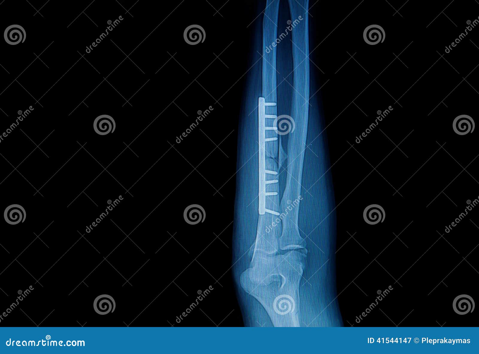 Fracture Forearm with Internal Fixed by Plate Stock Image - Image of ...