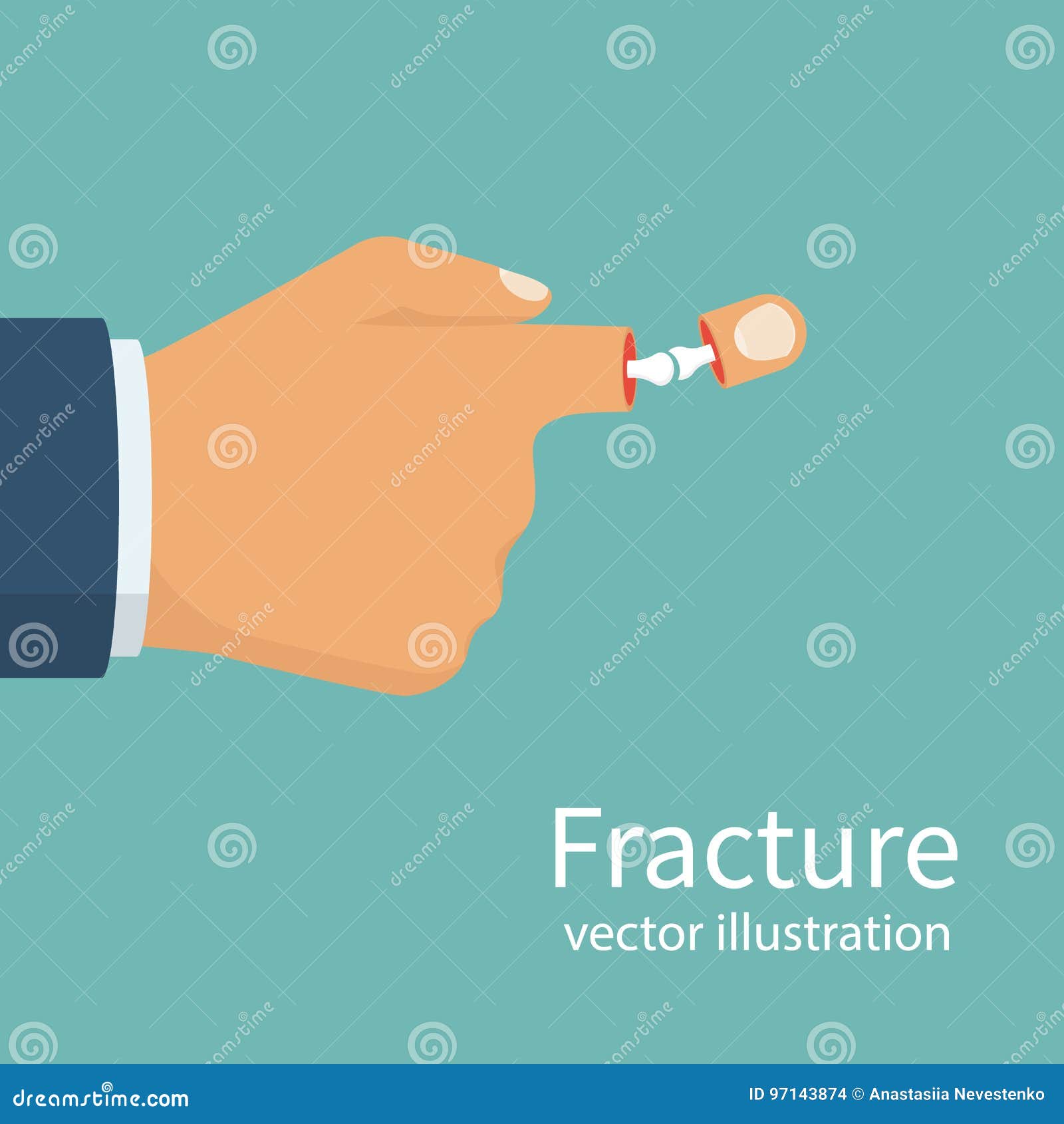 Broken Finger In In A Cast Bandage, Orthopedic Gypsum, Injury Bone ...