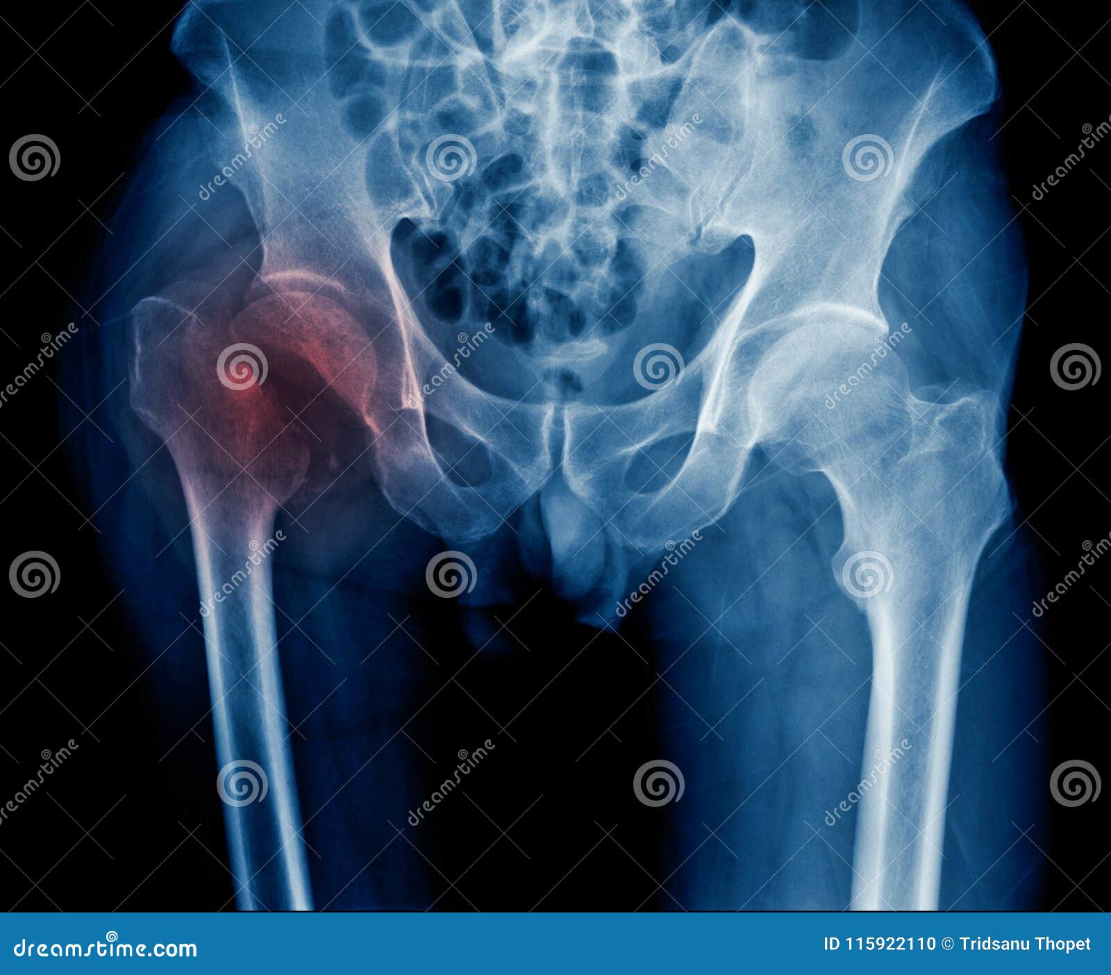 Fracture Intertrochanteric Of Hip Royalty-Free Stock Image ...