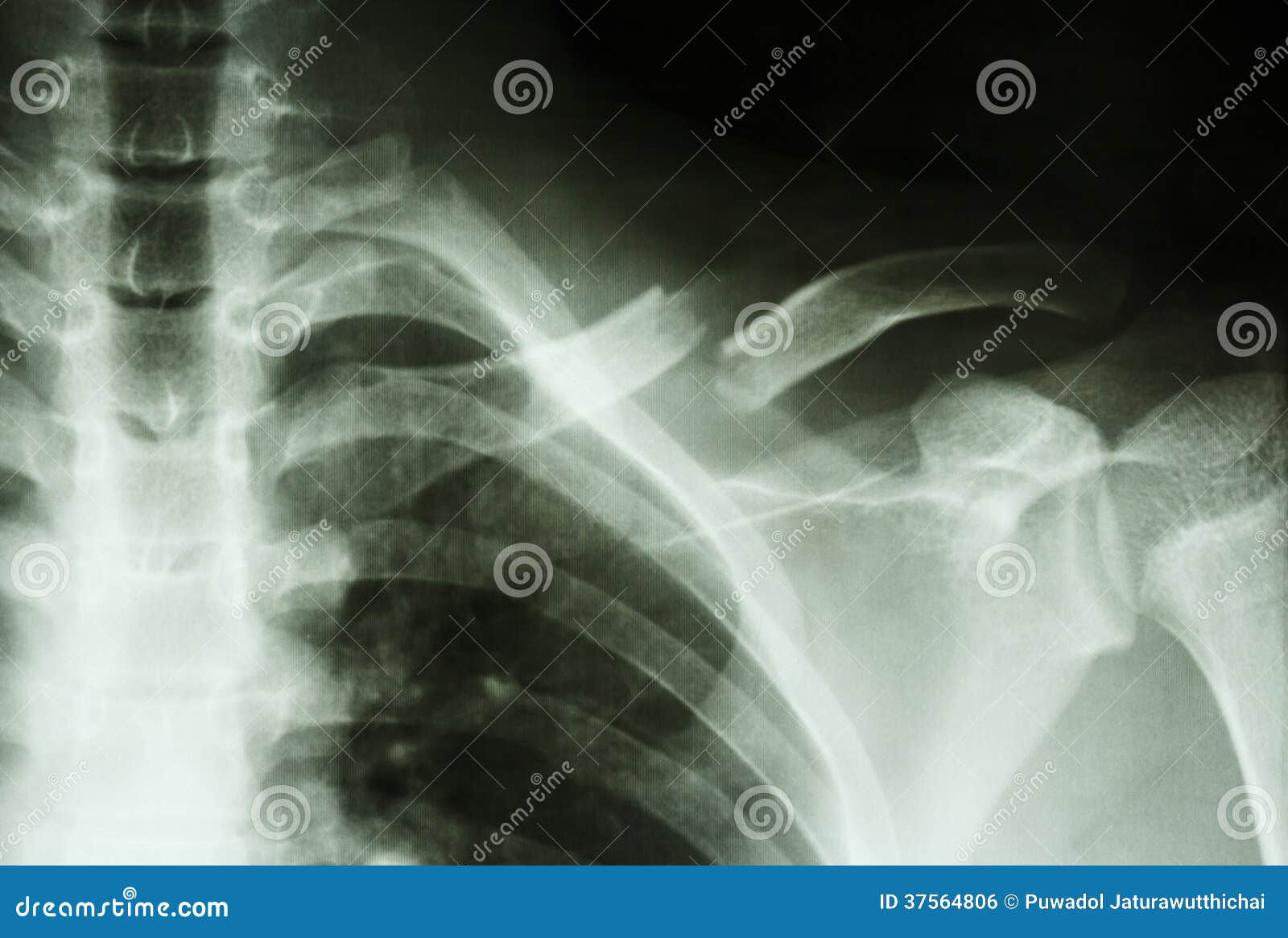 Fracture left clavicle stock photo. Image of disease - 37564806