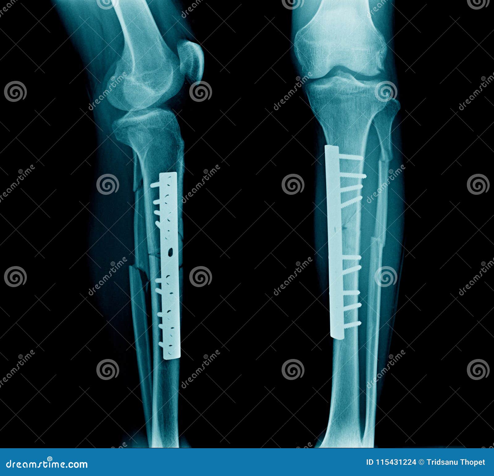 Fixed tibia bone x-ray stock photo. Image of disease - 115431224