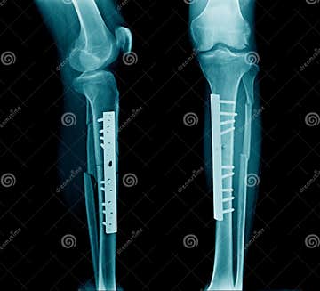 Fixed tibia bone x-ray stock photo. Image of disease - 115431224