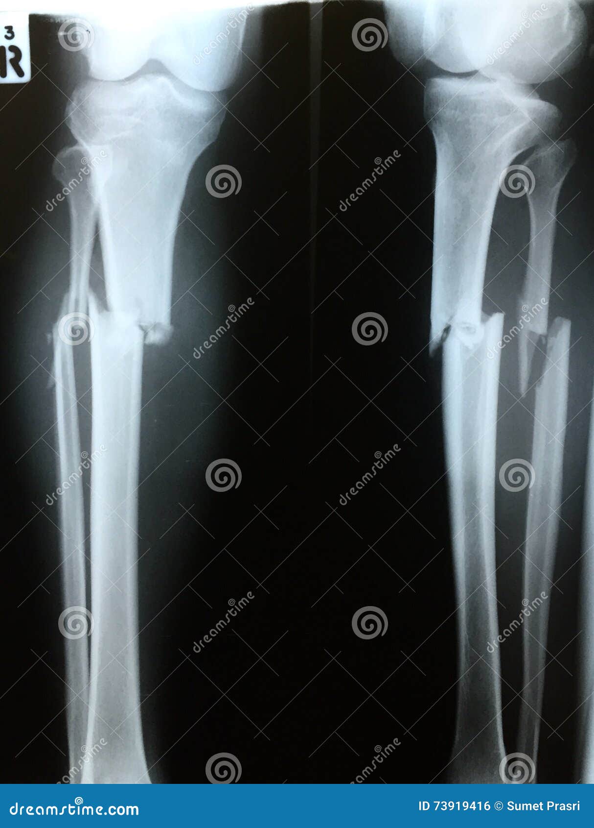 Fracture stock photo. Image of accident, fracture, light - 73919416
