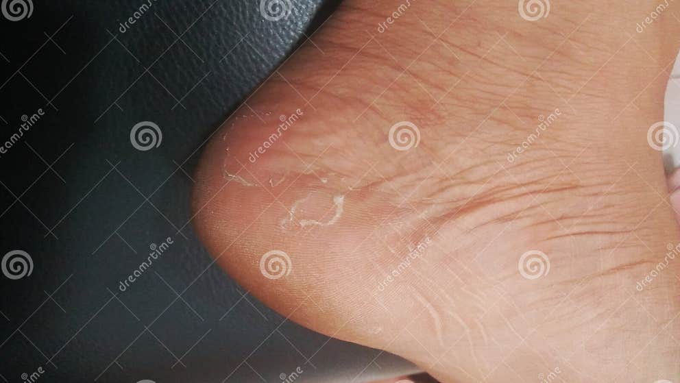 Fracture of the Outer Skin at the Toe Stock Image - Image of outer ...