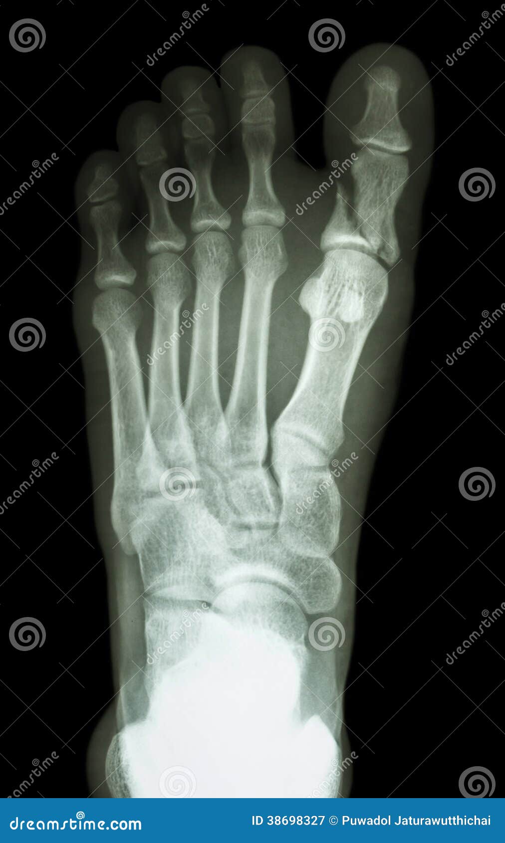 Fracture Proximal Phalange At First Toe Stock Image - Image of ...