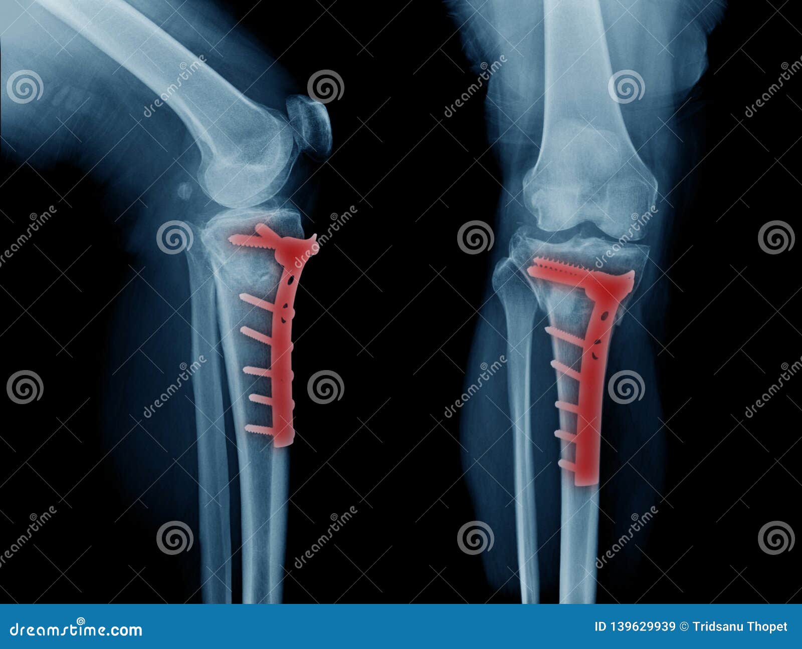 Fracture Proximal Tibia with Internal Fixation AP and Lateral View ...
