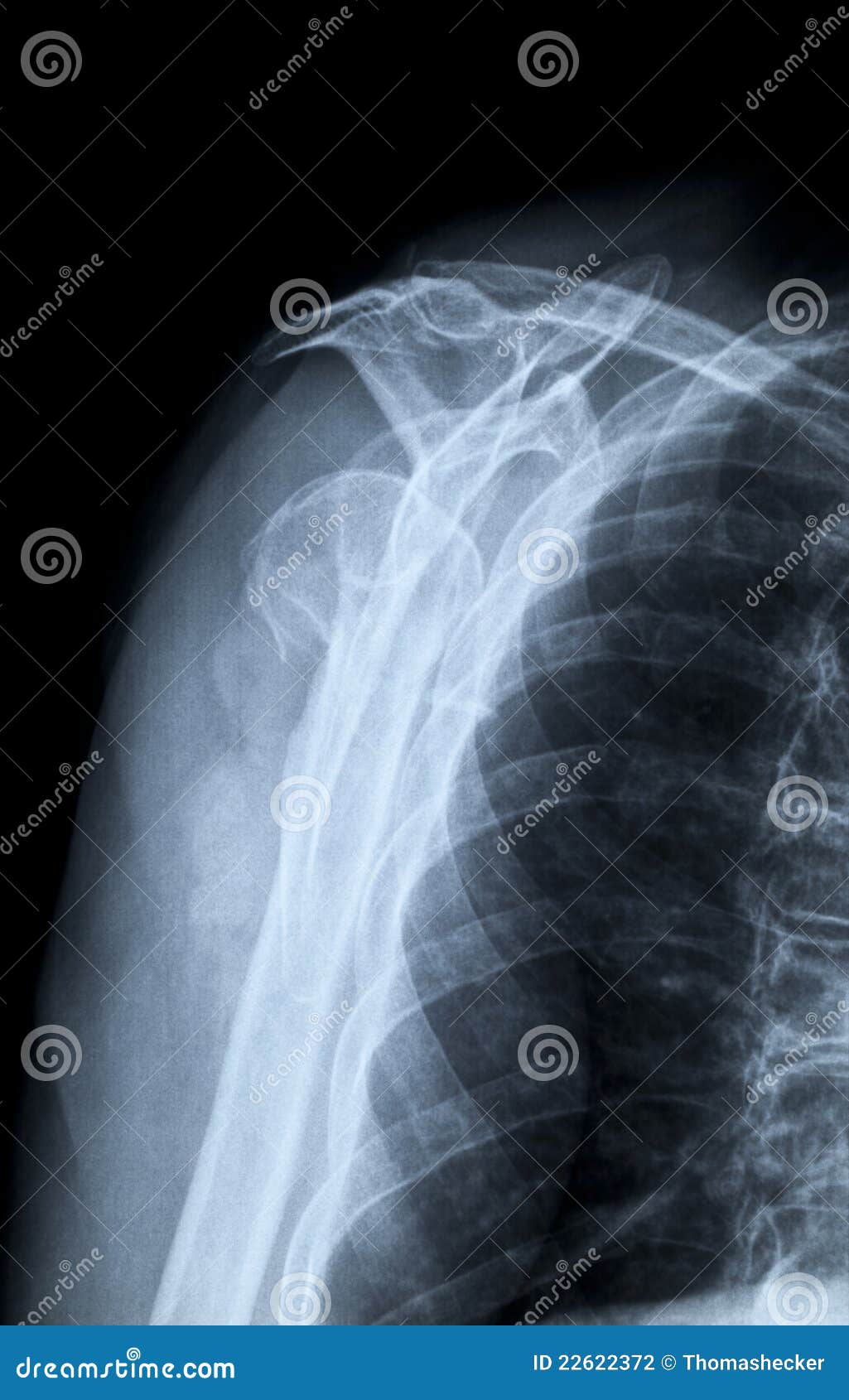 X-ray Fracture Of Acromion Process And Neck Of Humerus Royalty-Free ...