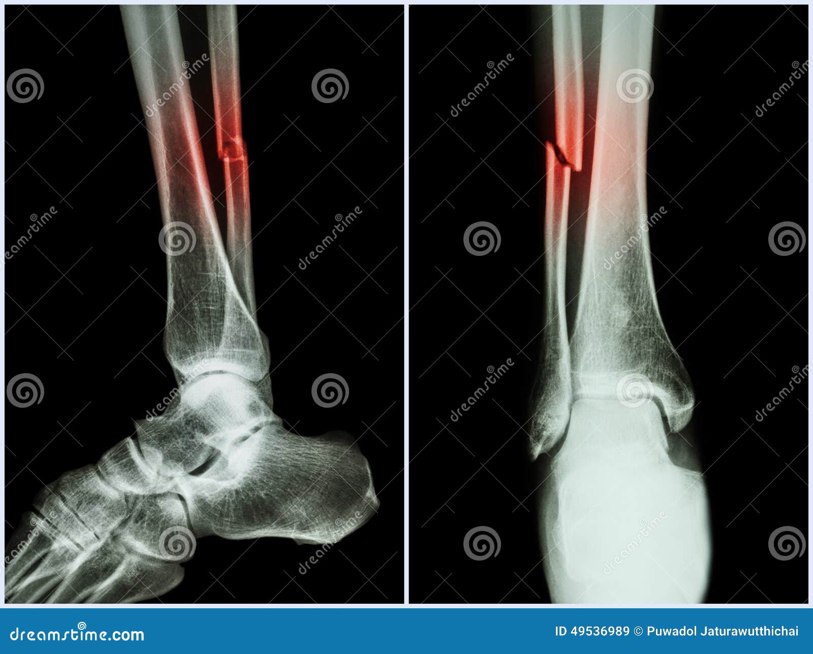 Fracture Shaft Of Fibula Bone ( Leg Bone ) . X-ray Of Leg ( 2 Position ...