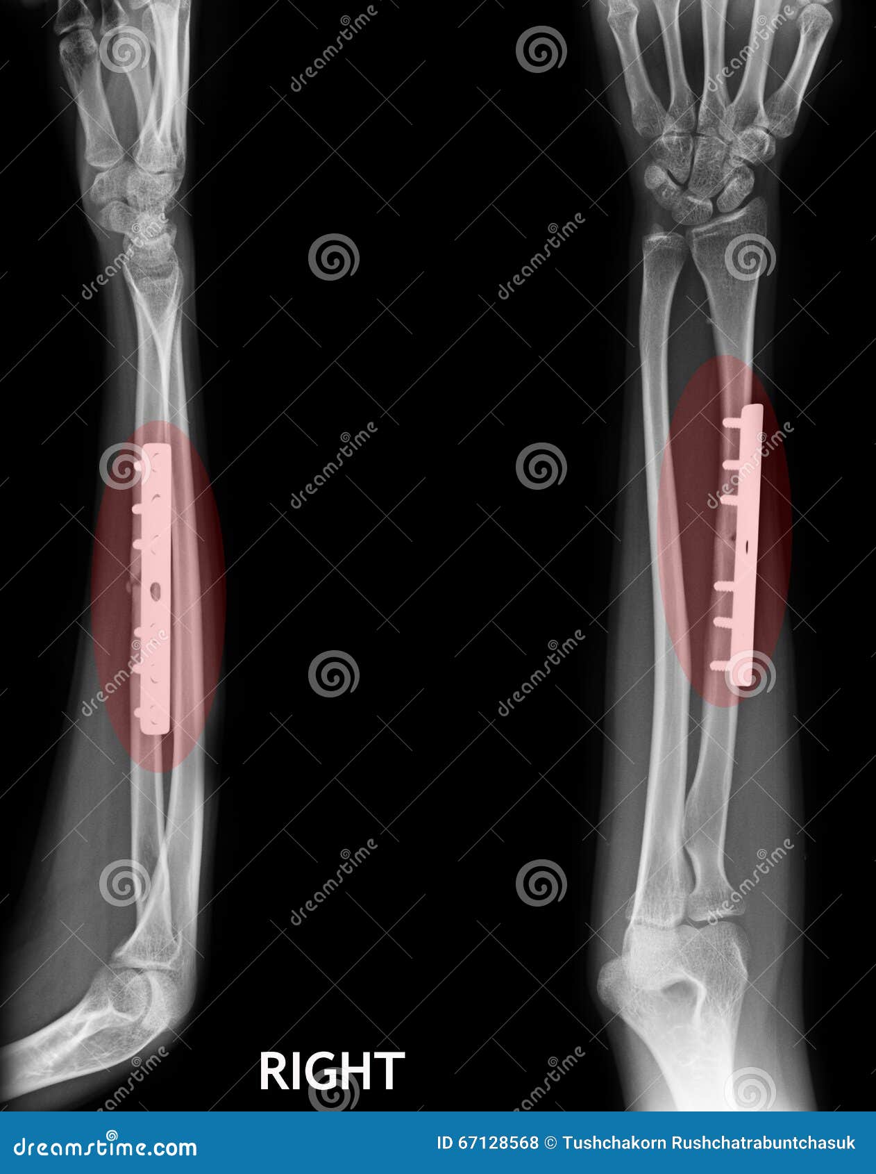 Fracture Shaft of Radius & Ulnar Bone Stock Photo - Image of anatomy ...