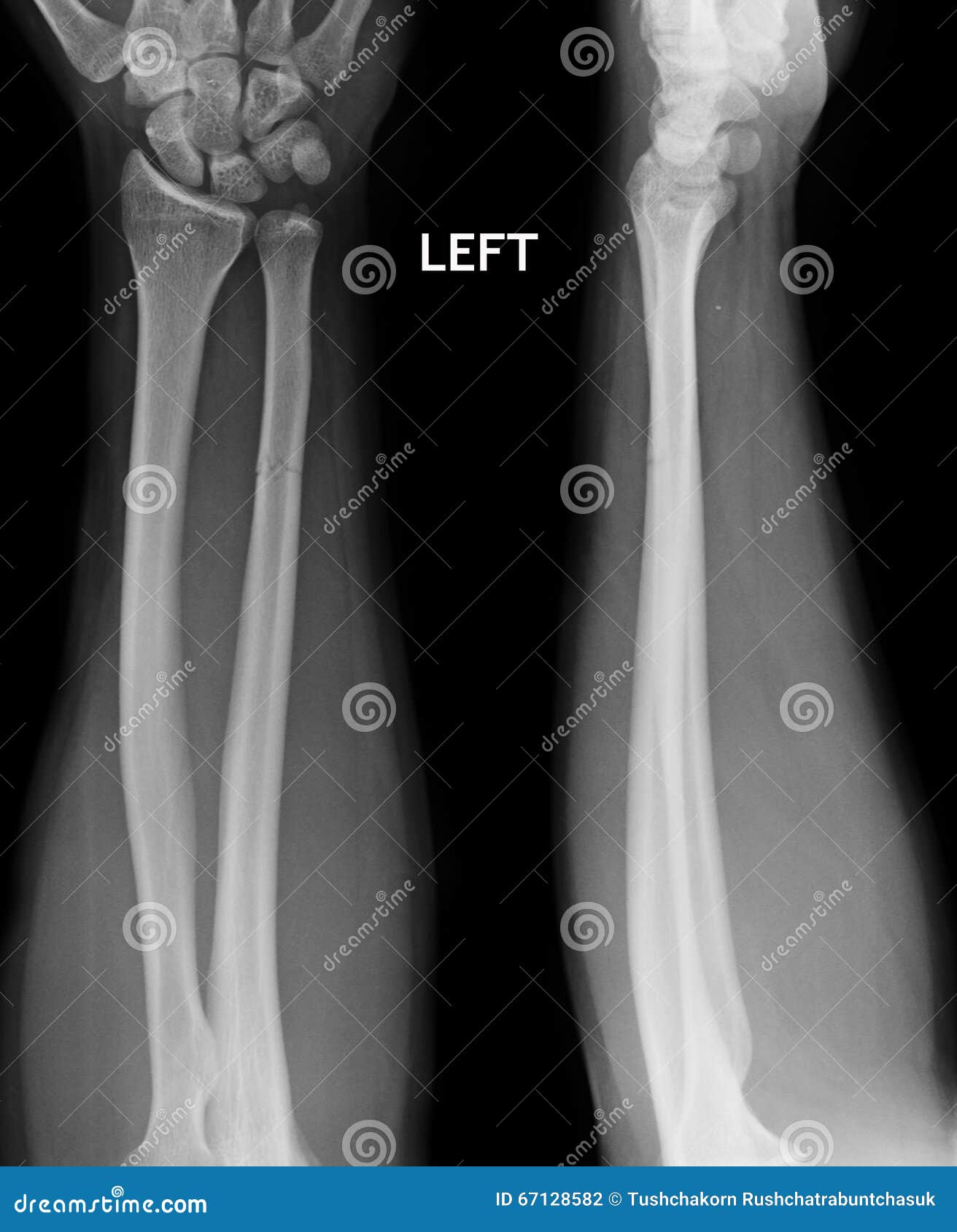 Fracture Shaft of Radius & Ulnar Bone Stock Photo - Image of hand, limb ...