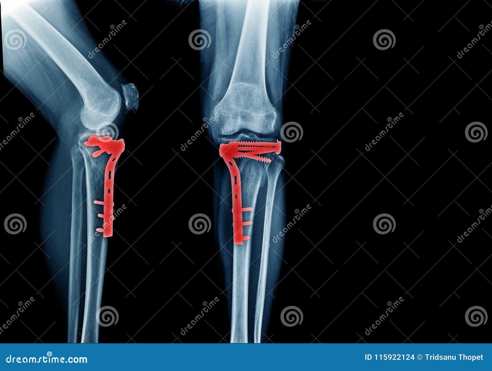 Proximal tibia fixation stock photo. Image of diagnosis - 115922124