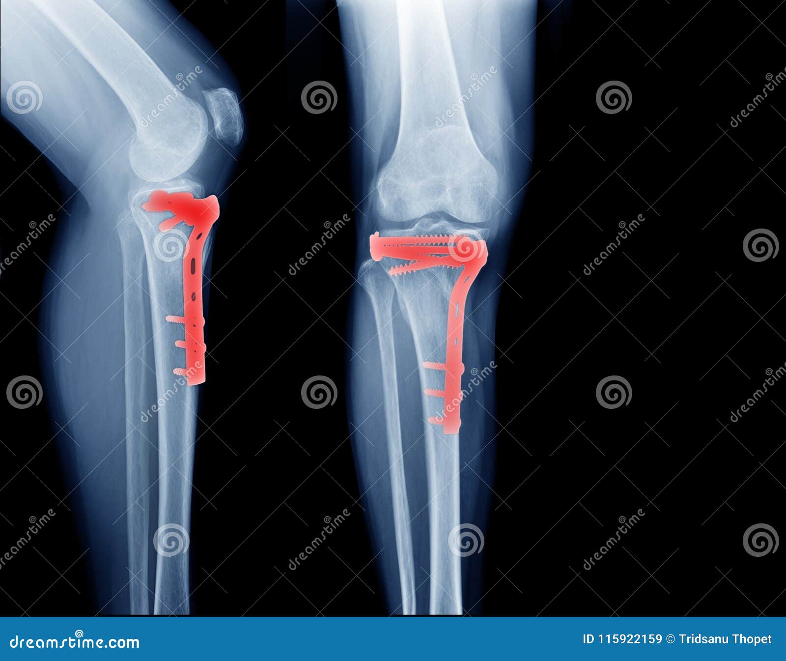 Fracture Tibia Bone With Post Op Fixation Stock Photo | CartoonDealer ...
