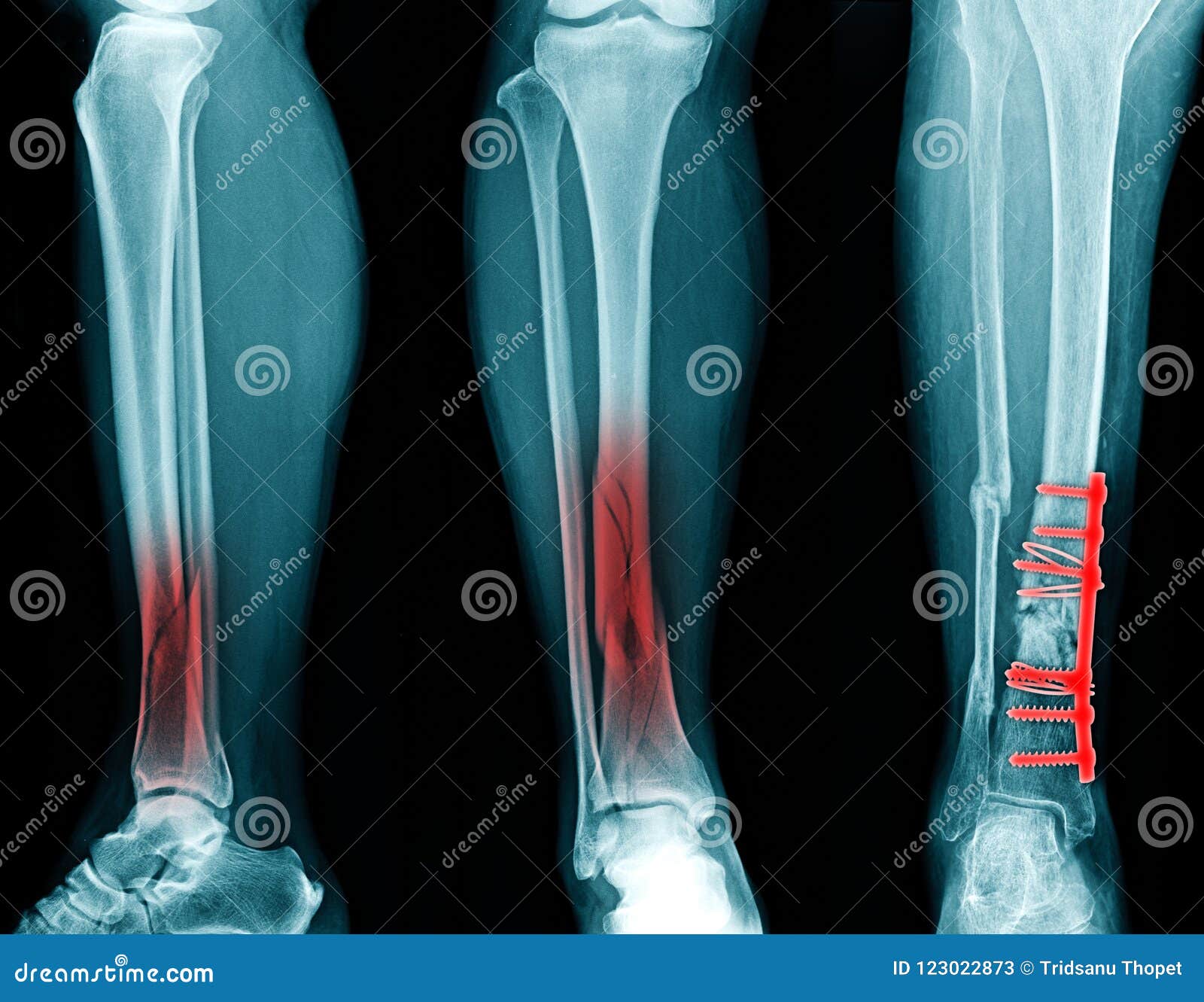 Fracture Tibia And Fixed Stock Image | CartoonDealer.com #123022873