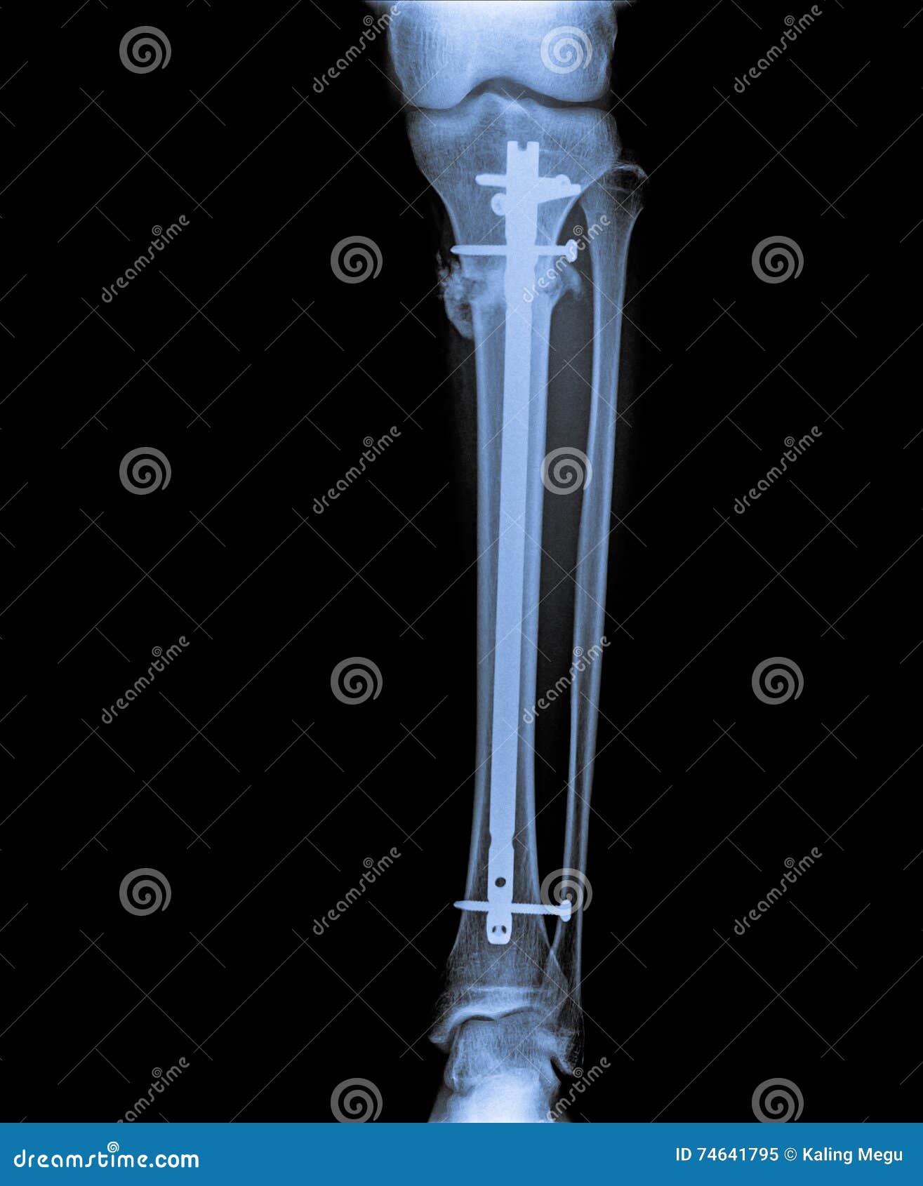 Fracture Tibia with Implant Stock Image - Image of health, fracture ...