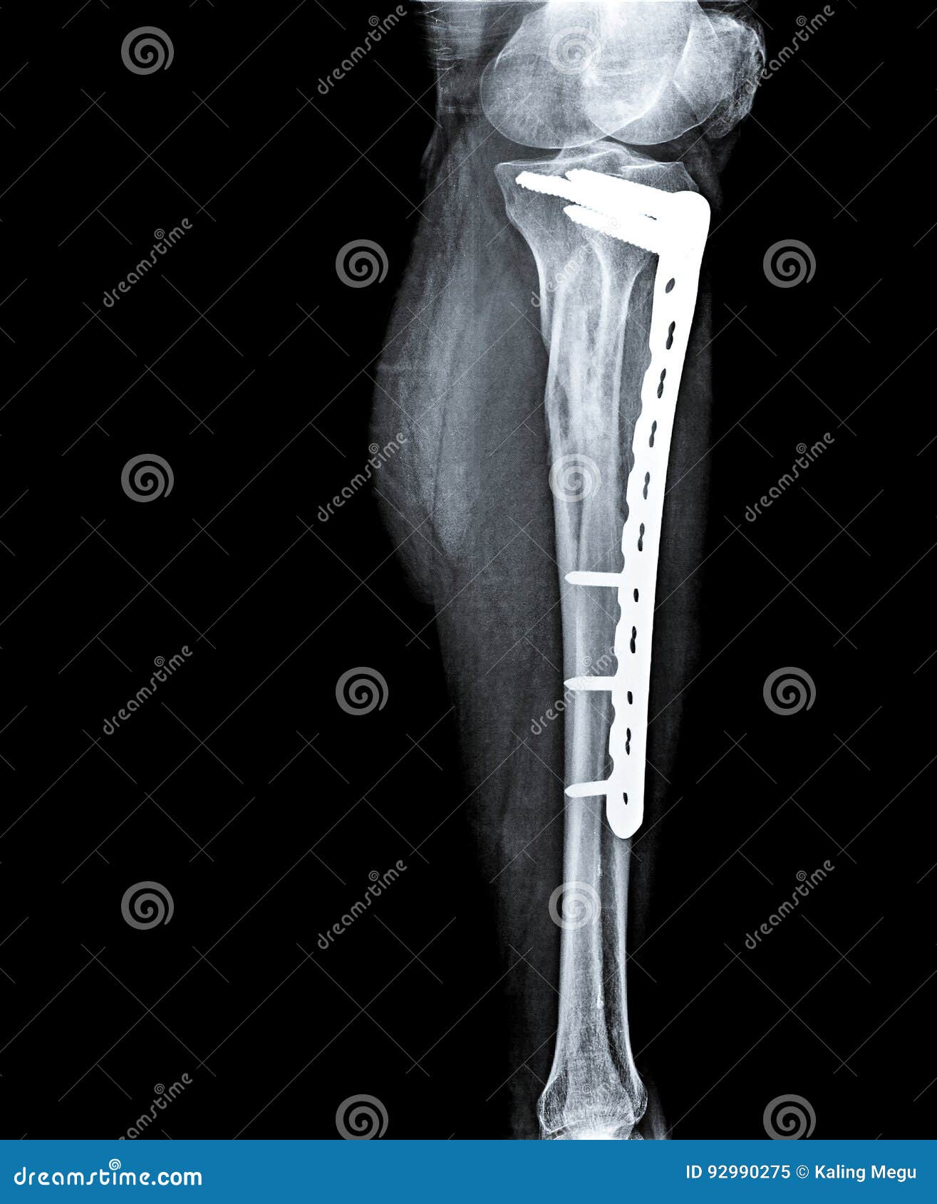 Fracture Tibia with Implant Stock Image - Image of care, knee: 92990275