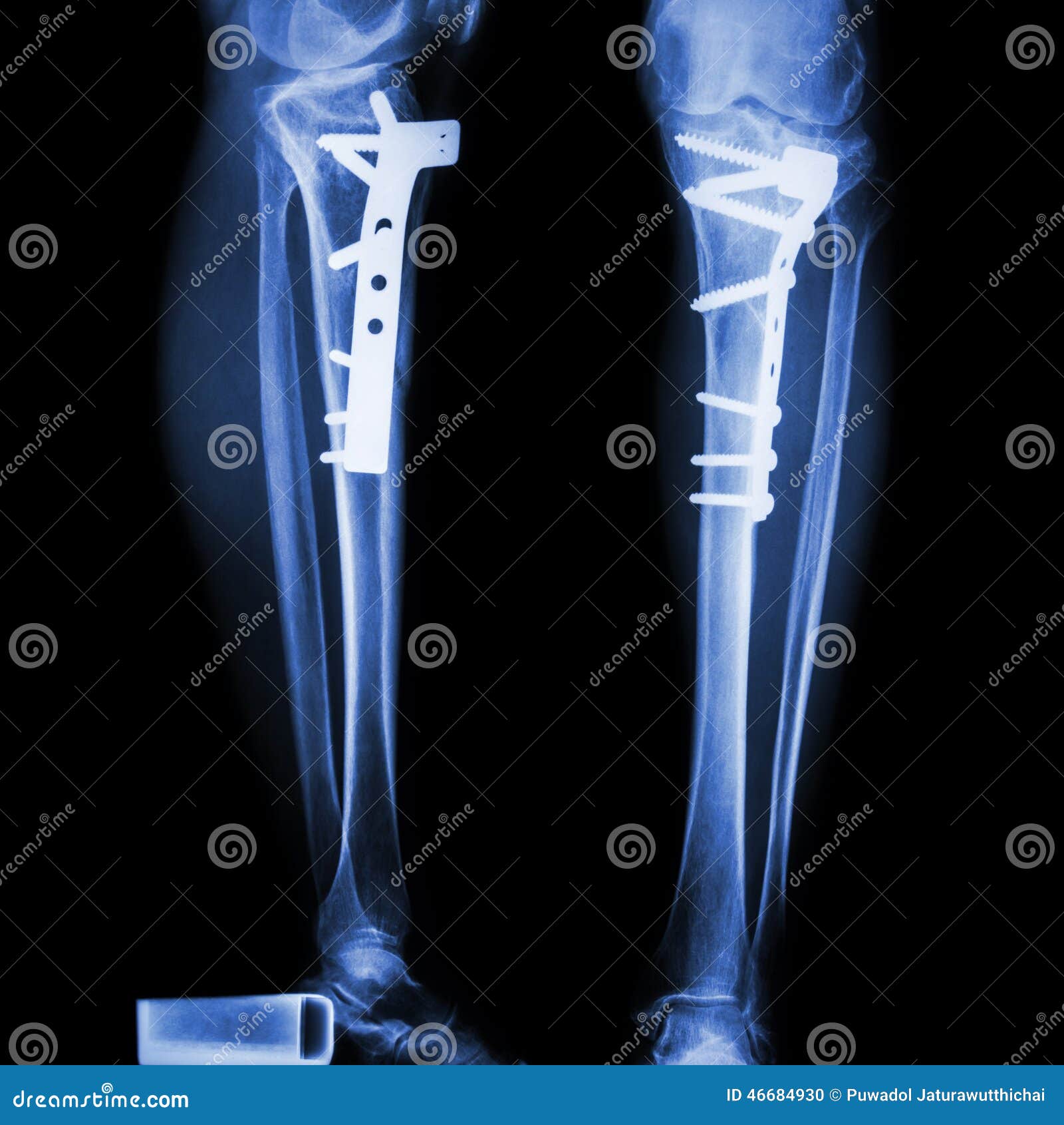 Fracture Tibia(leg Bone). it Was Operated and Internal Fixed Stock ...