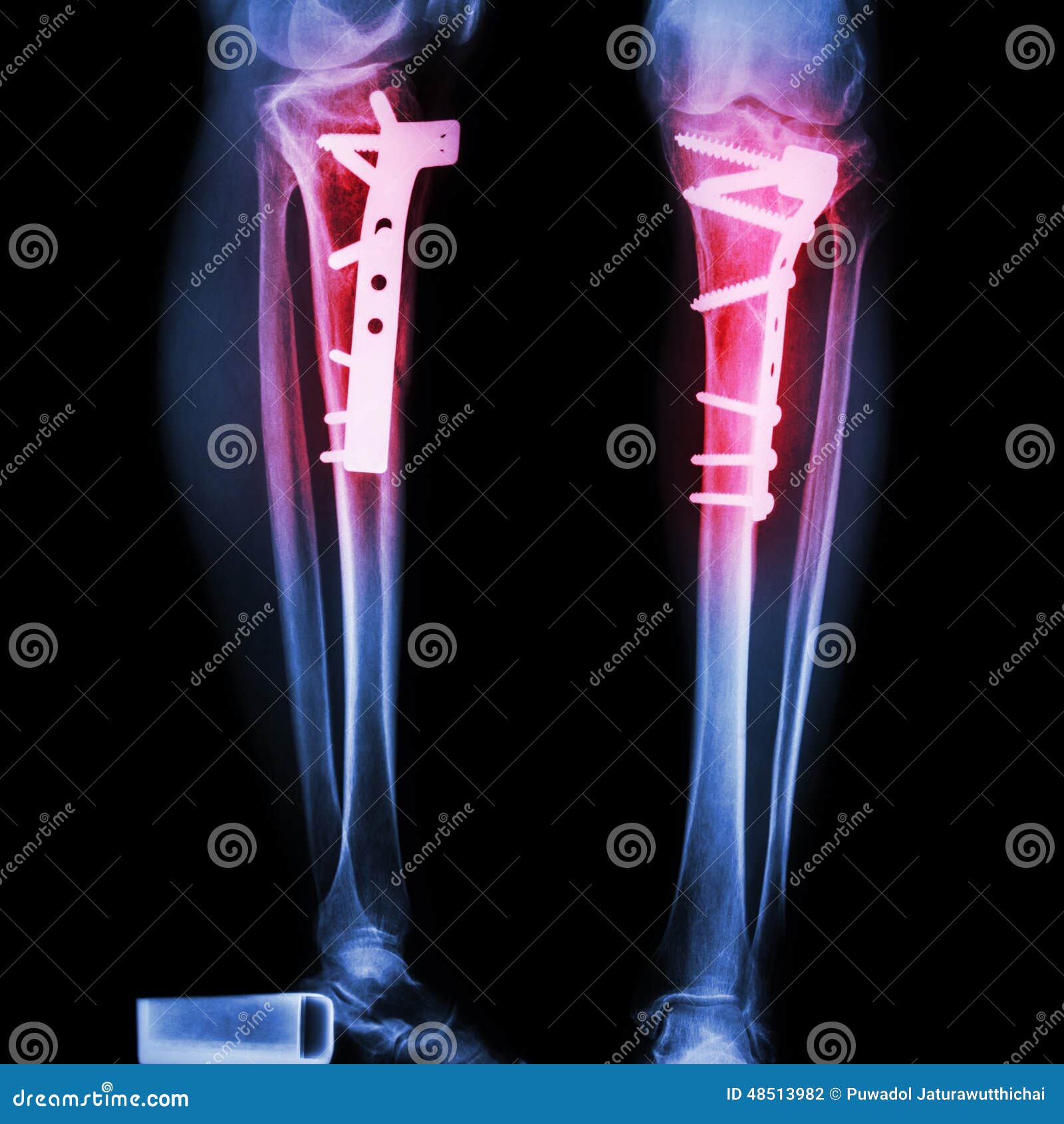 Fracture Tibia And Fixed Stock Image | CartoonDealer.com #123022873