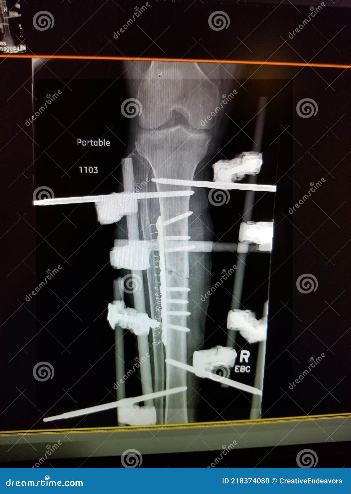 Fracture Tibiale Droite Avec Fixation Interne Photo stock - Image of ...