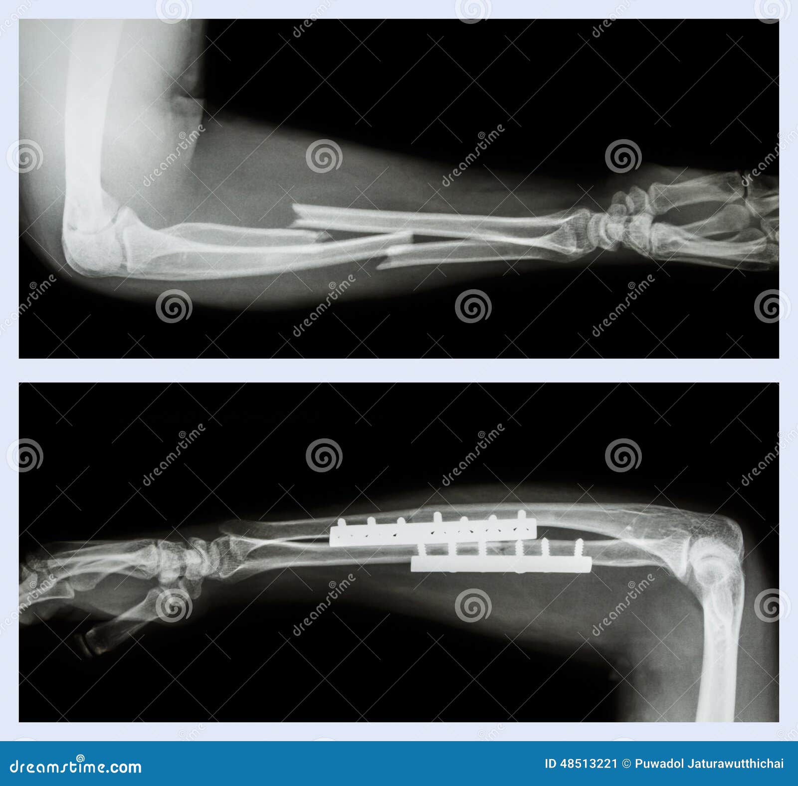 Fracture Ulnar and Radius (Forearm Bone) Stock Image - Image of lower ...