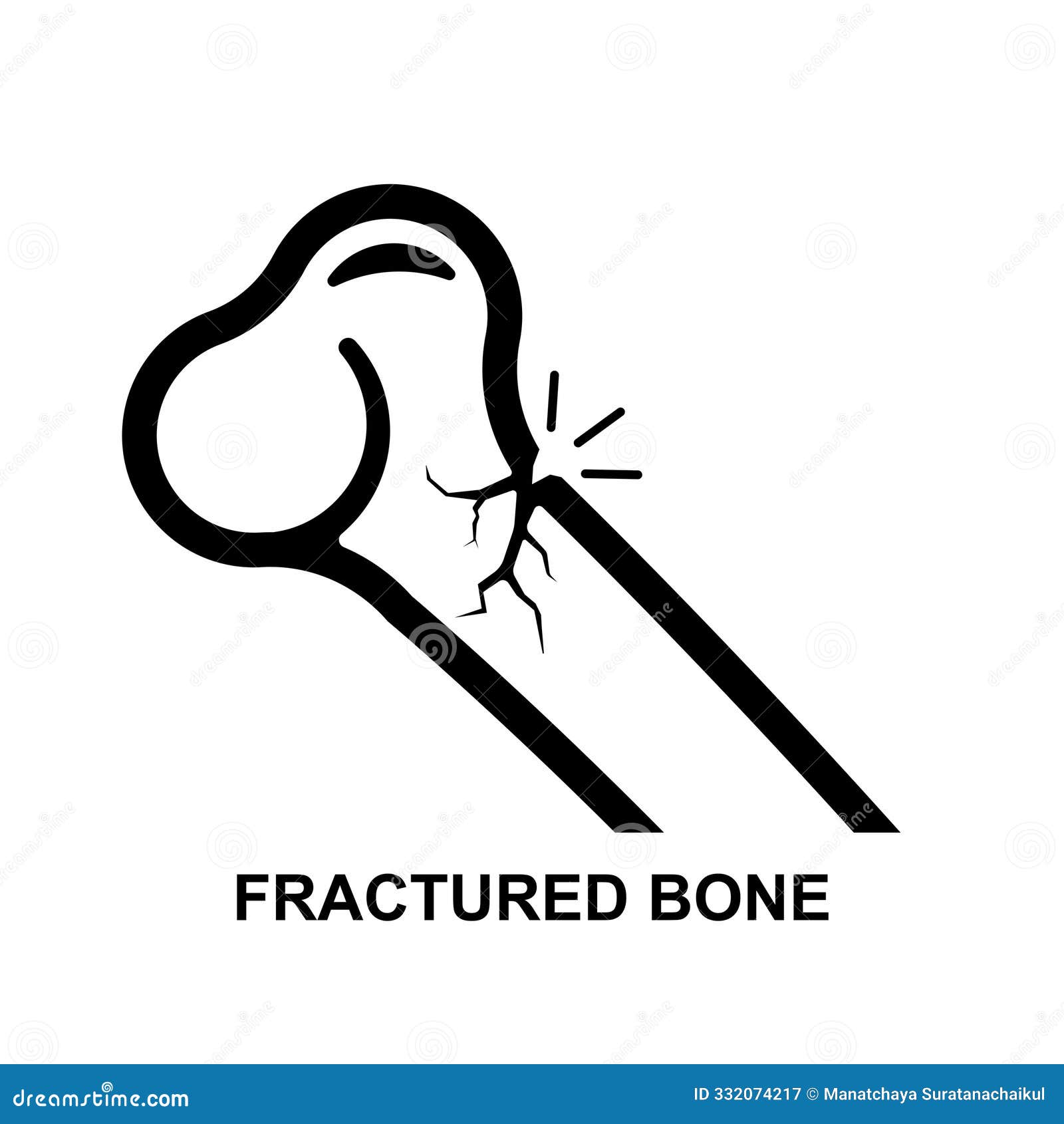 Spiral Bone Fracture. Infographics. Vector Illustration On A Lined ...