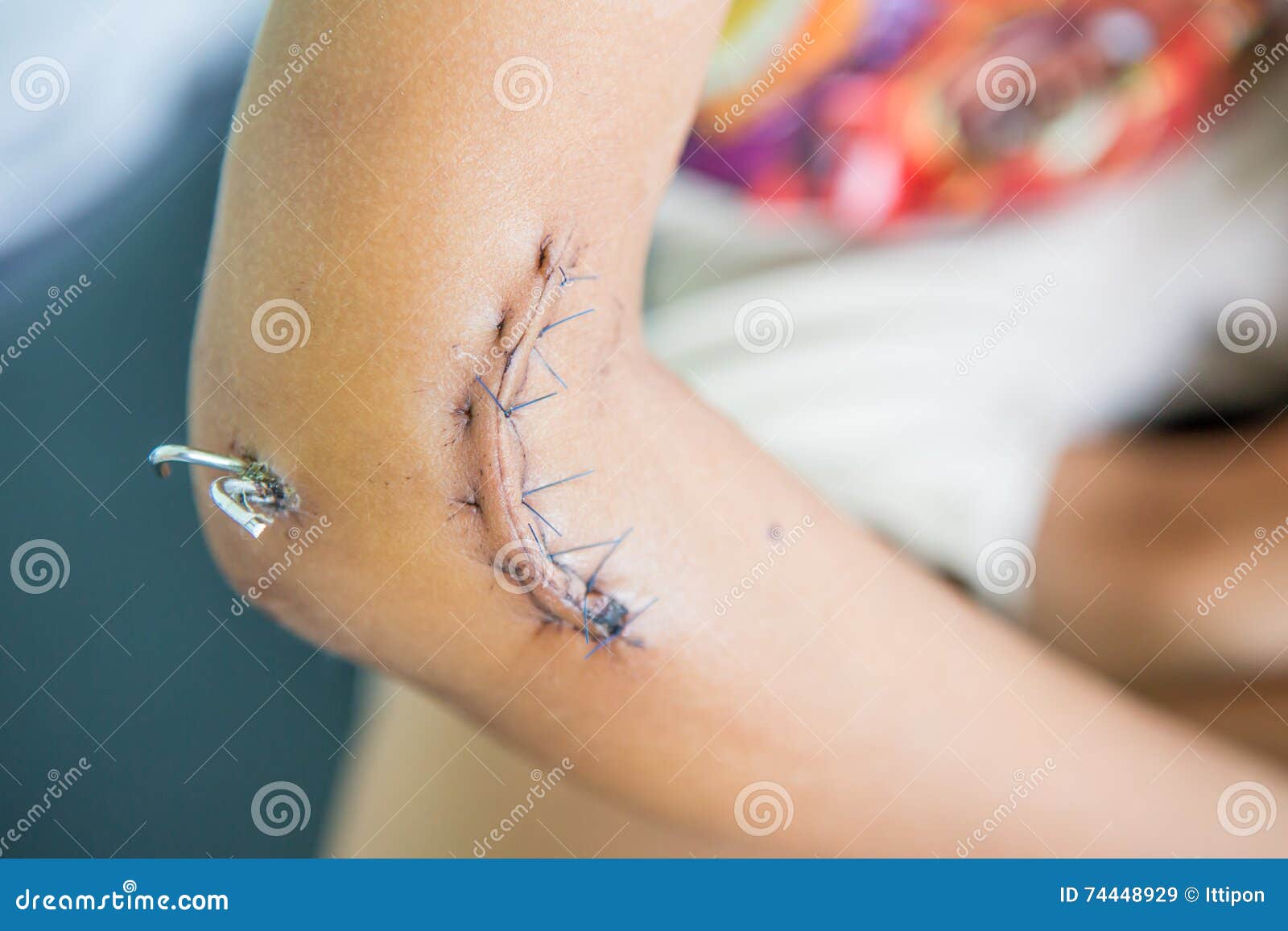 Fractured elbow stock image. Image of child, radiography - 74448929