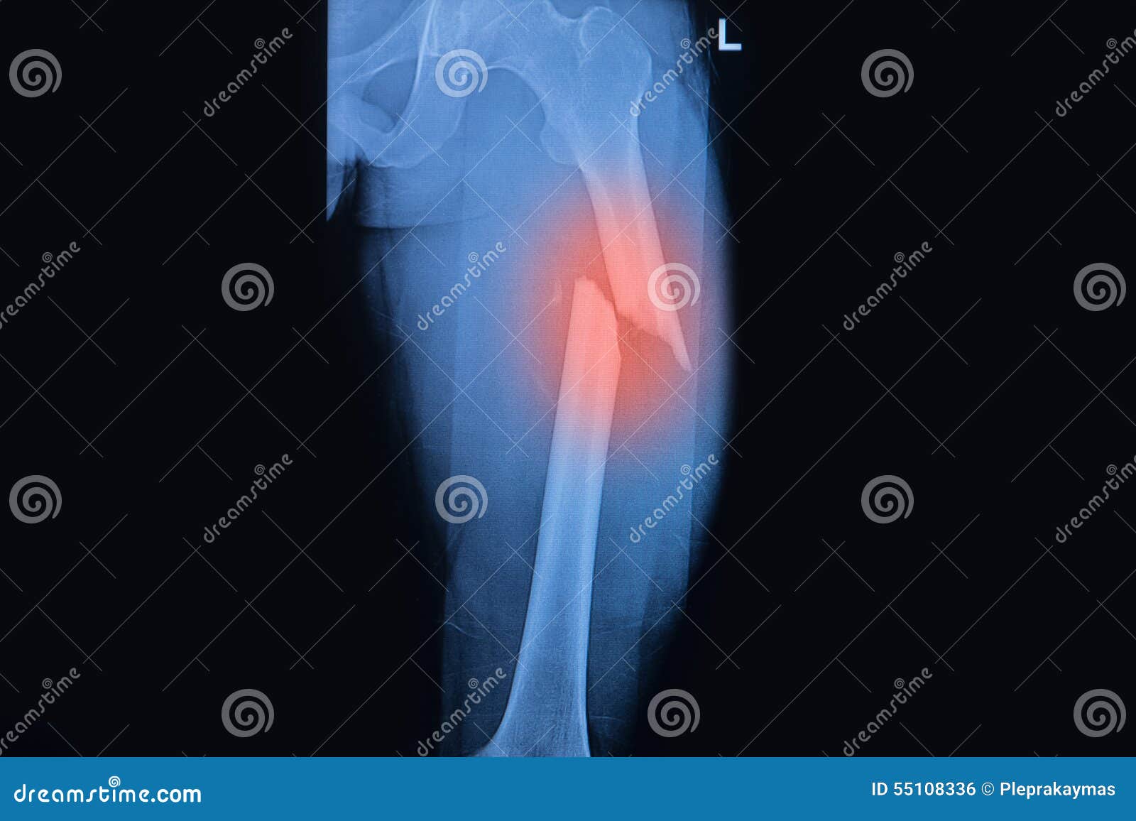 Fractured Femur, Broken Thigh X-rays Stock Photo - Image of injury ...