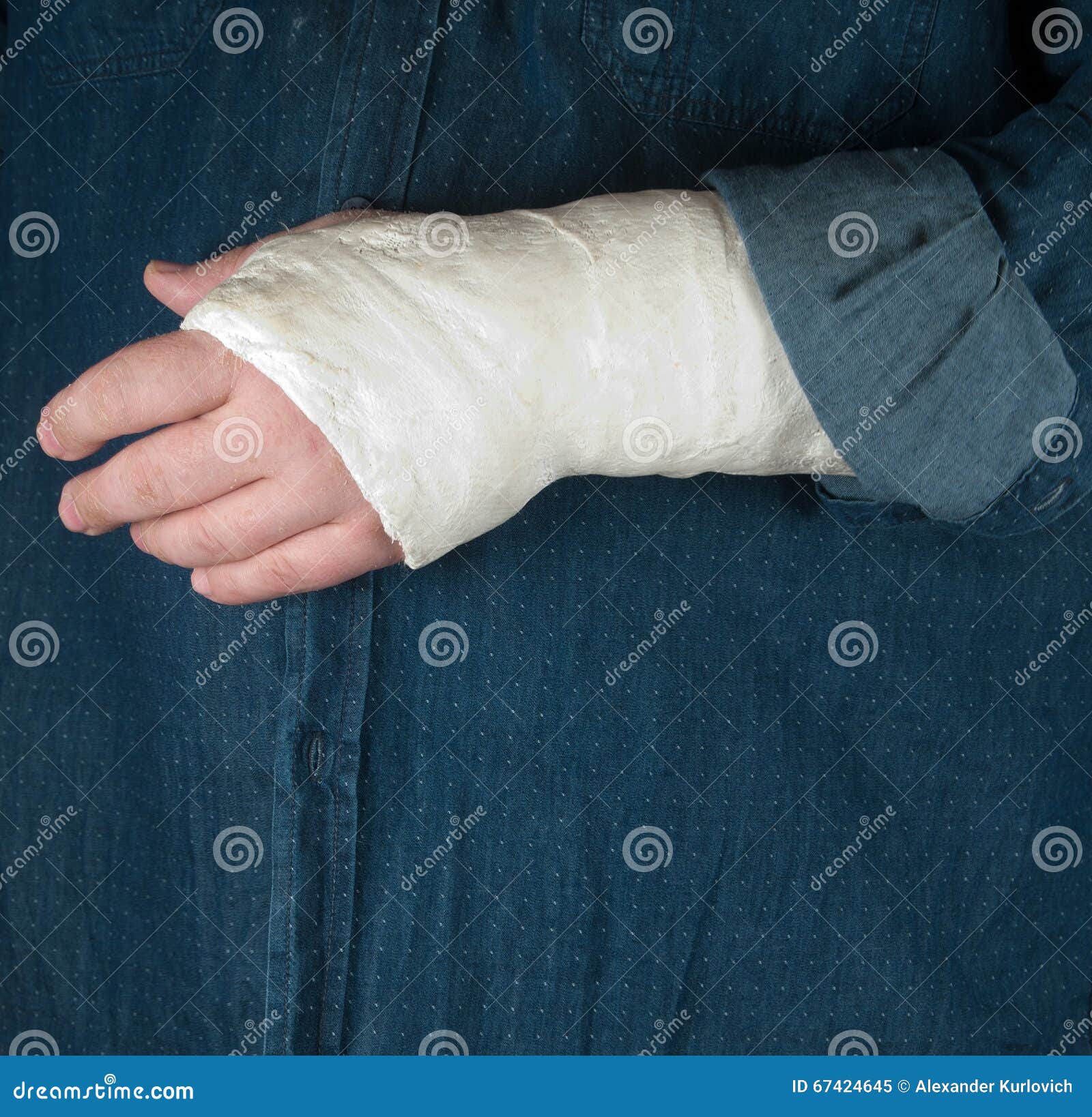 Fractured Hand in a Gypsum Plaster Stock Image - Image of colles, left ...