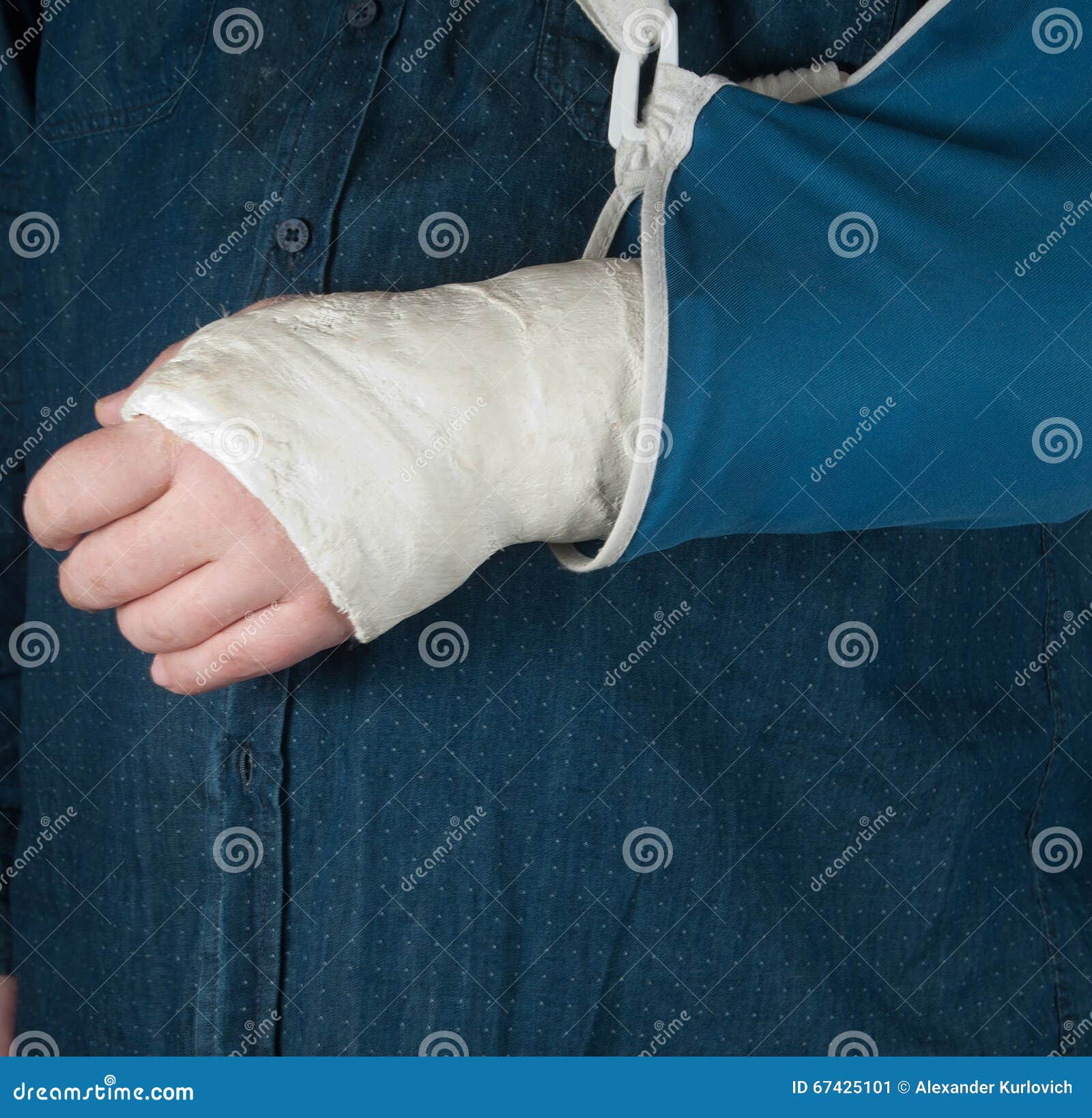 Fractured Hand in a Gypsum Plaster Stock Image - Image of colles, ache ...