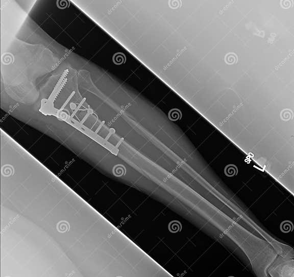 Fractured Leg bones stock image. Image of anatomy, health - 8601085
