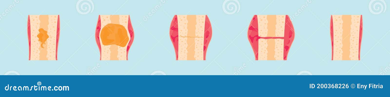 Fractures And Healing Process Cartoon Icon Design Template With Various ...