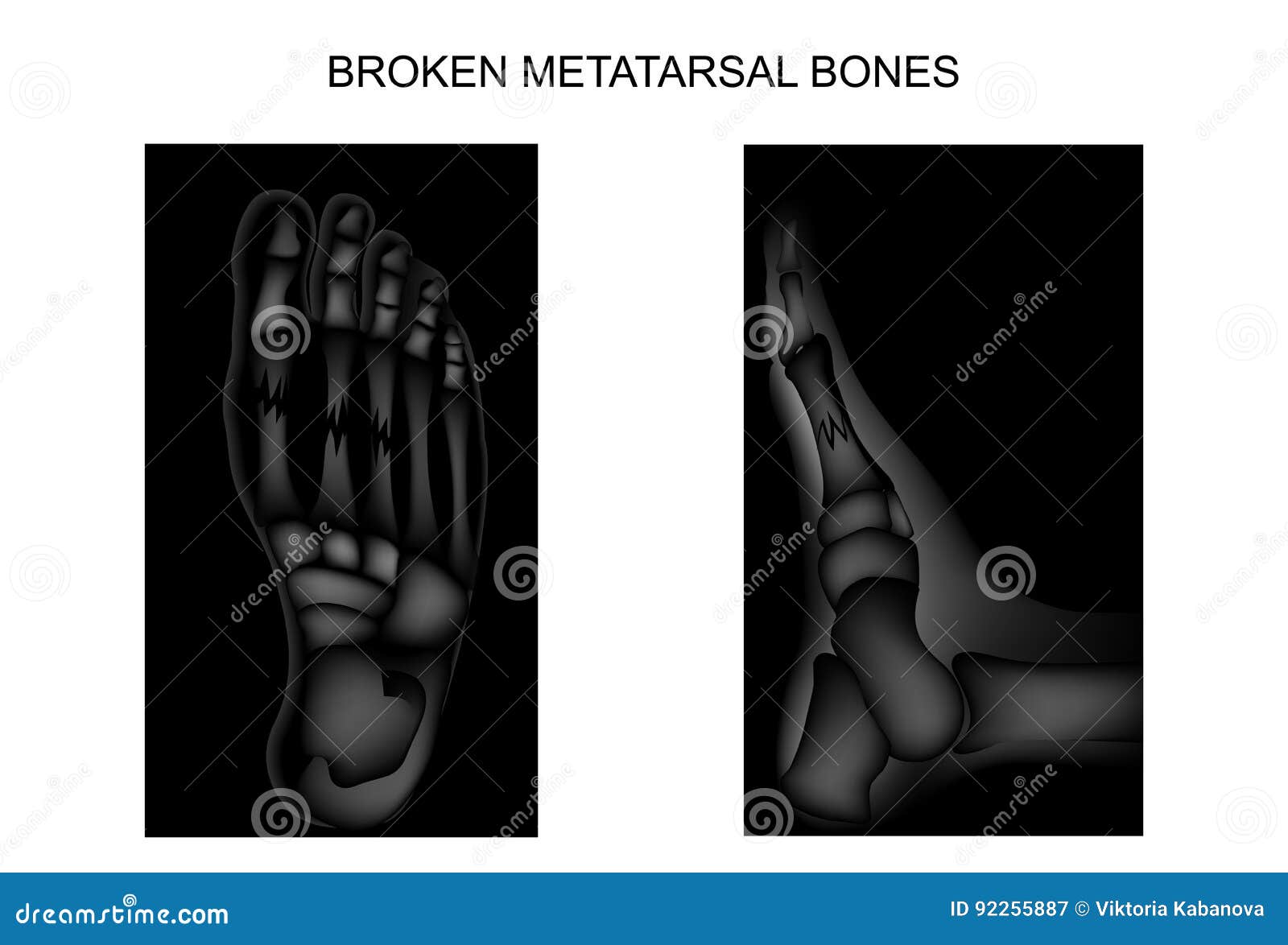 Bones Of The Foot .Tarsals Or Tarsus, Metatarsals, Phalanges Cartoon ...