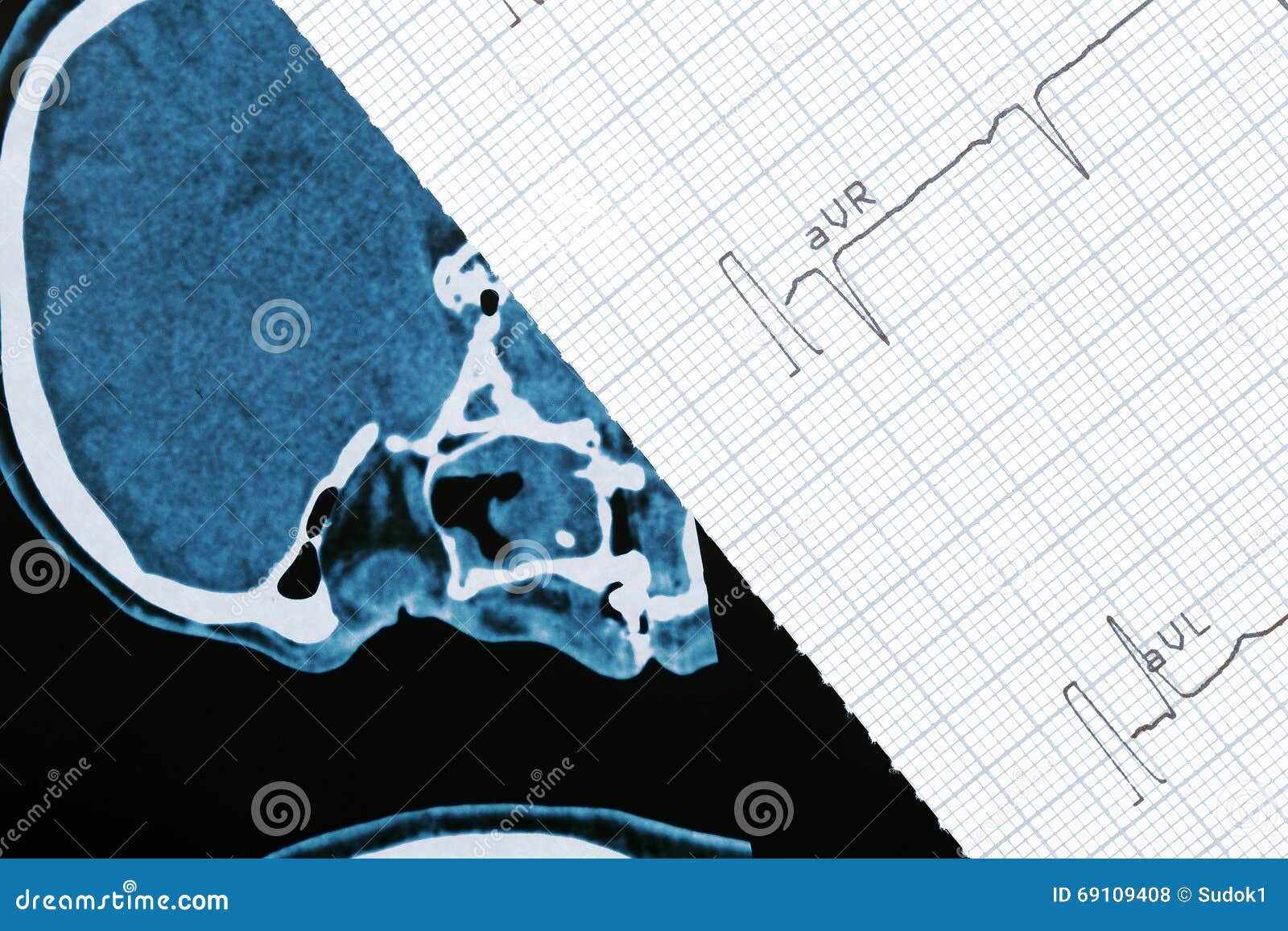 Fragment of CT Scann and Cardiogram Stock Photo - Image of discovery ...