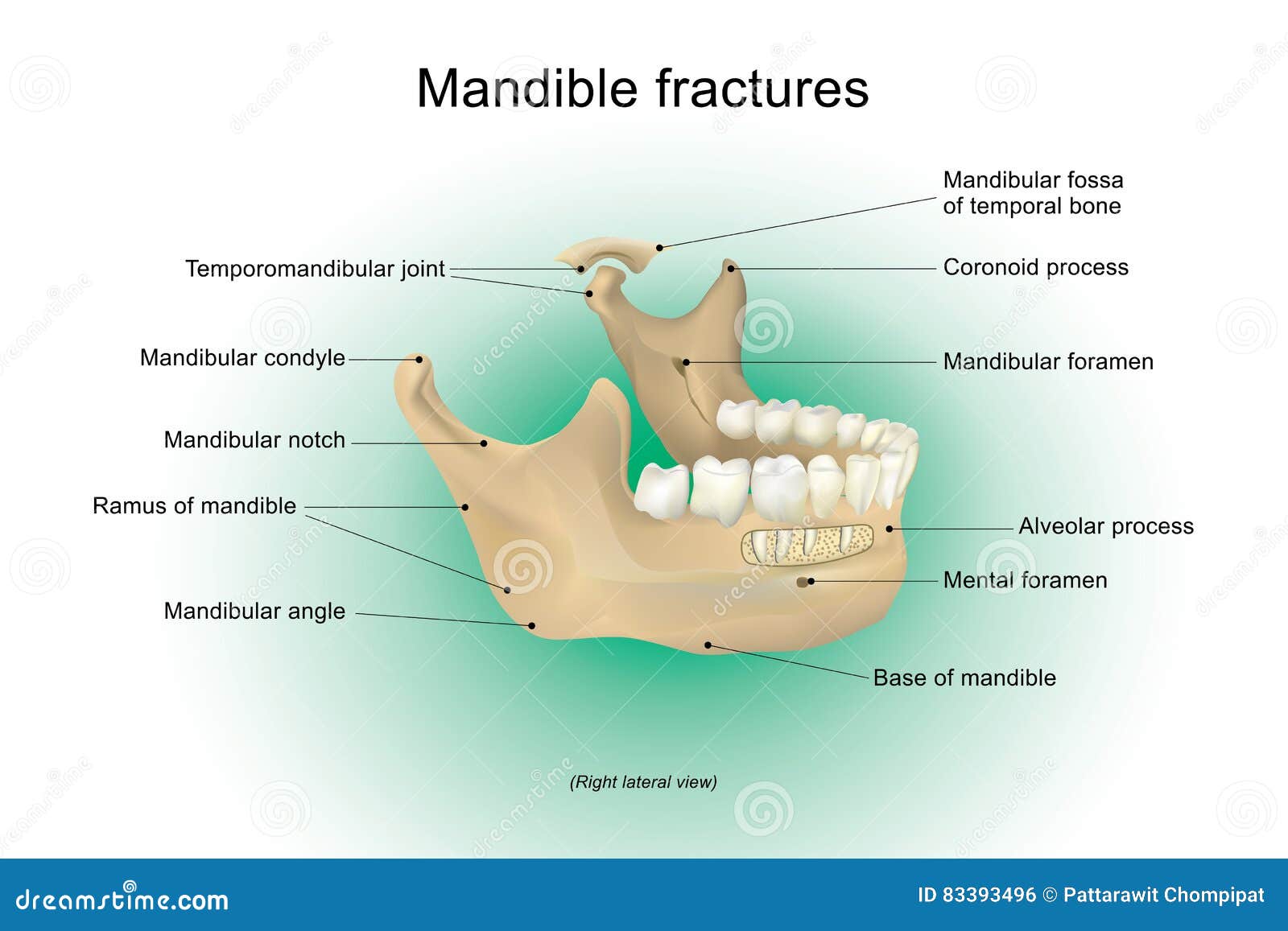 Fratture della mandibola illustrazione di stock. Illustrazione di ...
