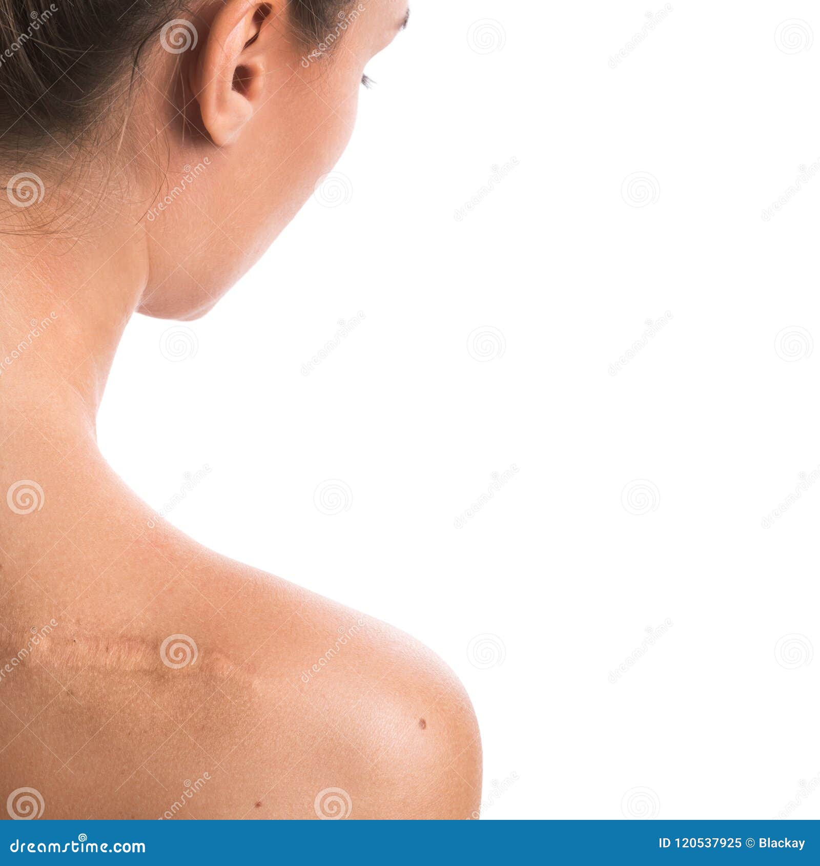 Frau Mit Einer Narbe Auf Ihrer Schulter Stockbild - Bild von ...