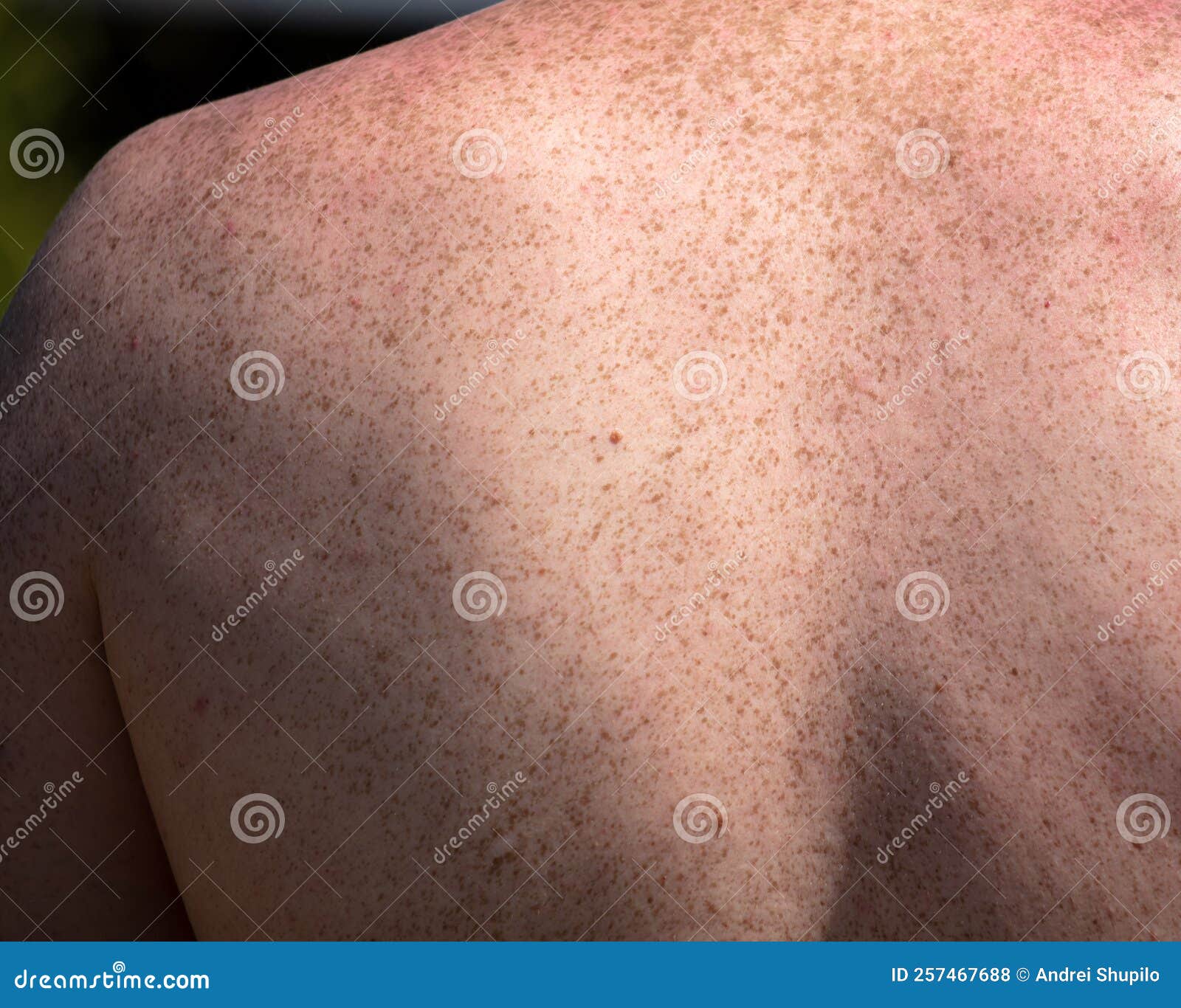 Freckle on the Back of a Man. Stock Photo - Image of cosmetology, back ...